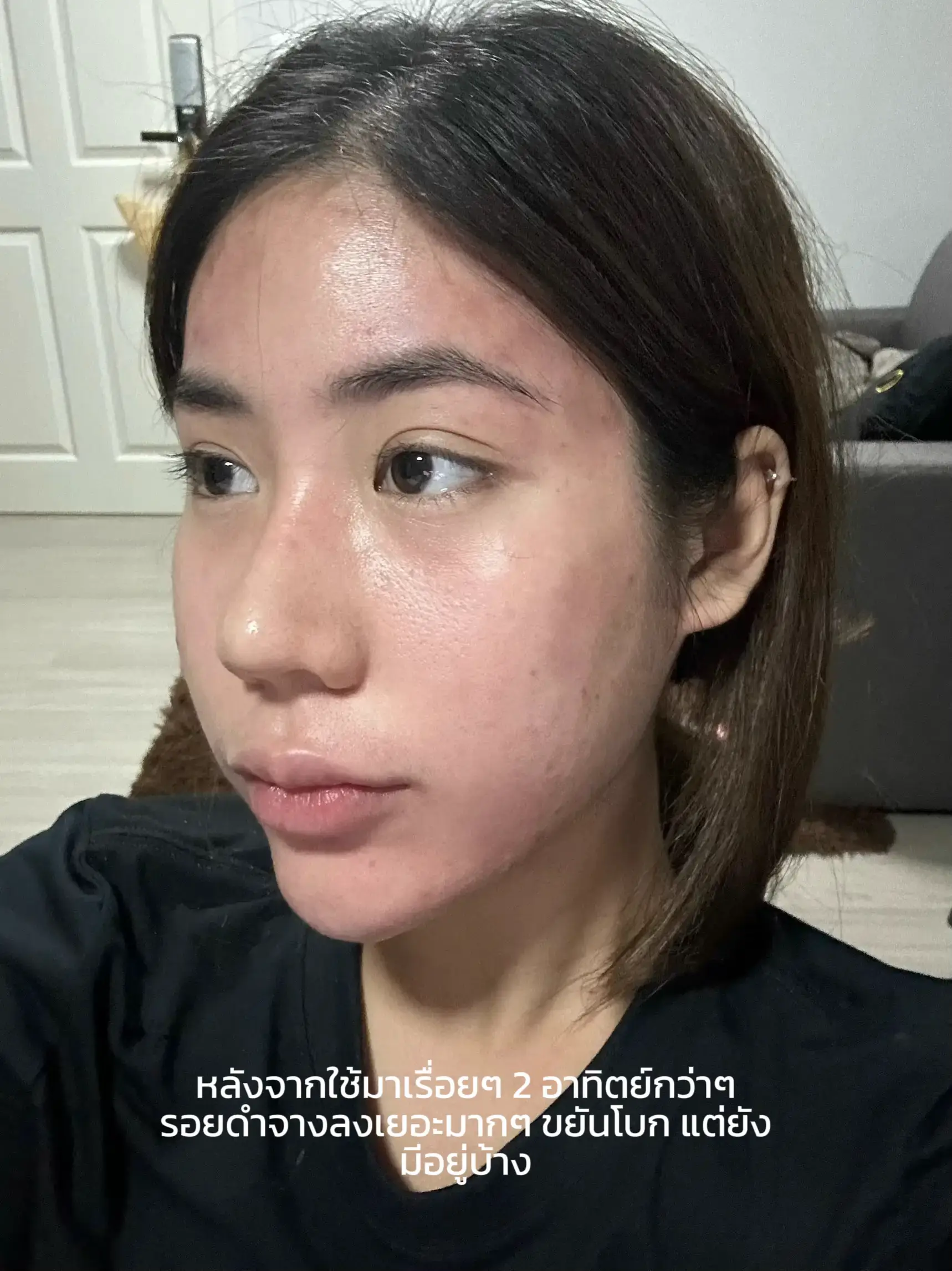 มหากาพย์รักษารอยสิวด้วยตัวเอง! | แกลเลอรีที่โพสต์โดย cherlin.er | Lemon8