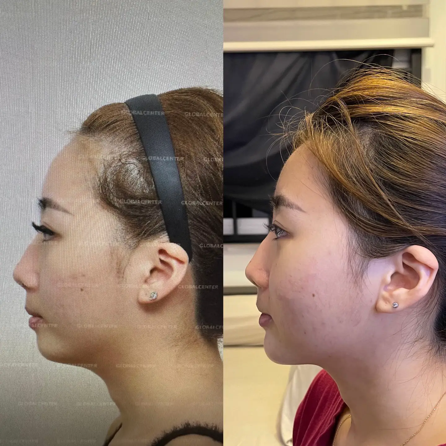 2nd Month Post-Op! (Buccal Fat/Lipo/Botox) | Gallery posted by Zara Lim ...