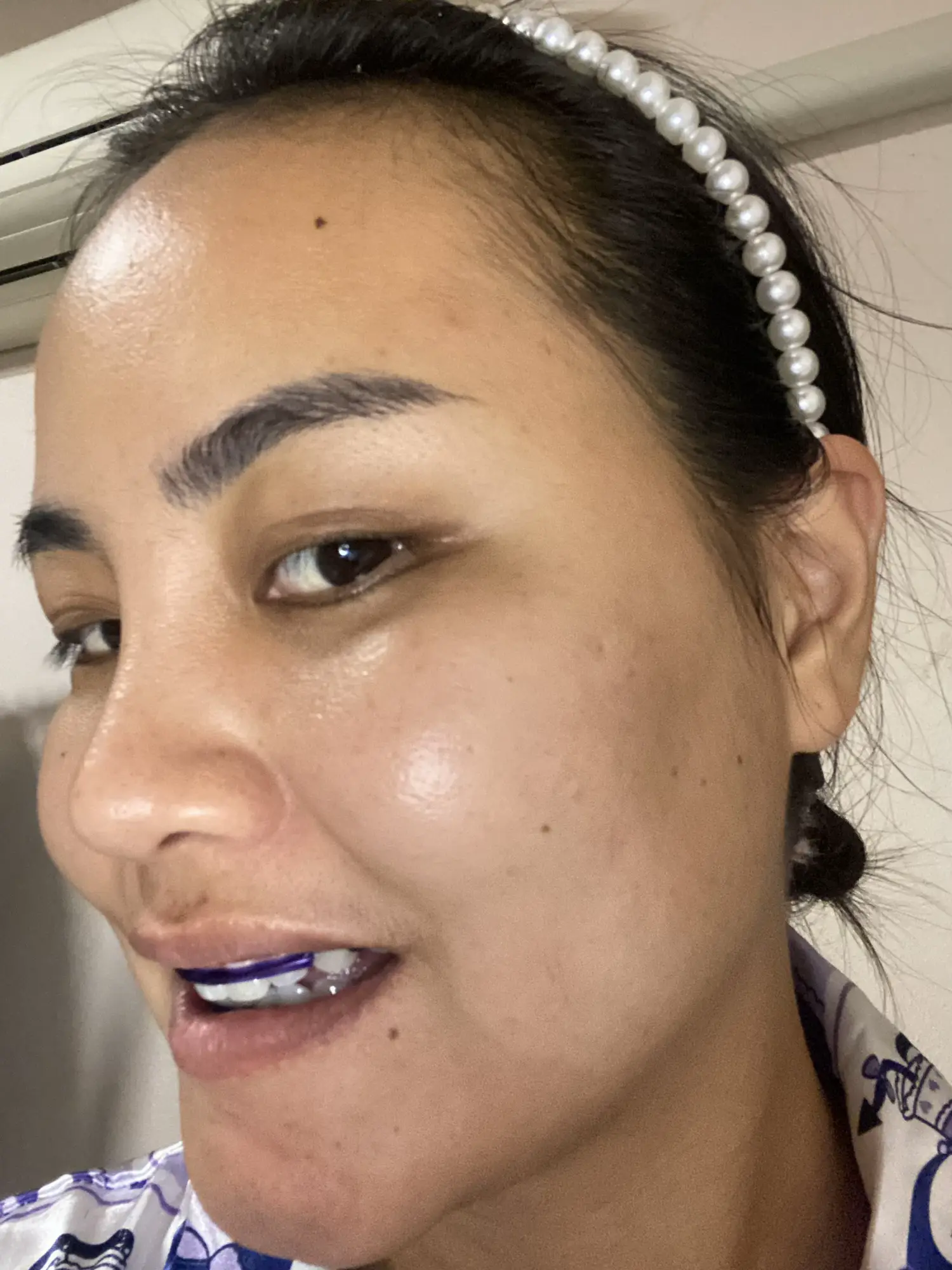 ขี้แมลงวันเต็มหน้าเลยจ้า | แกลเลอรีที่โพสต์โดย Pop Unjai | Lemon8