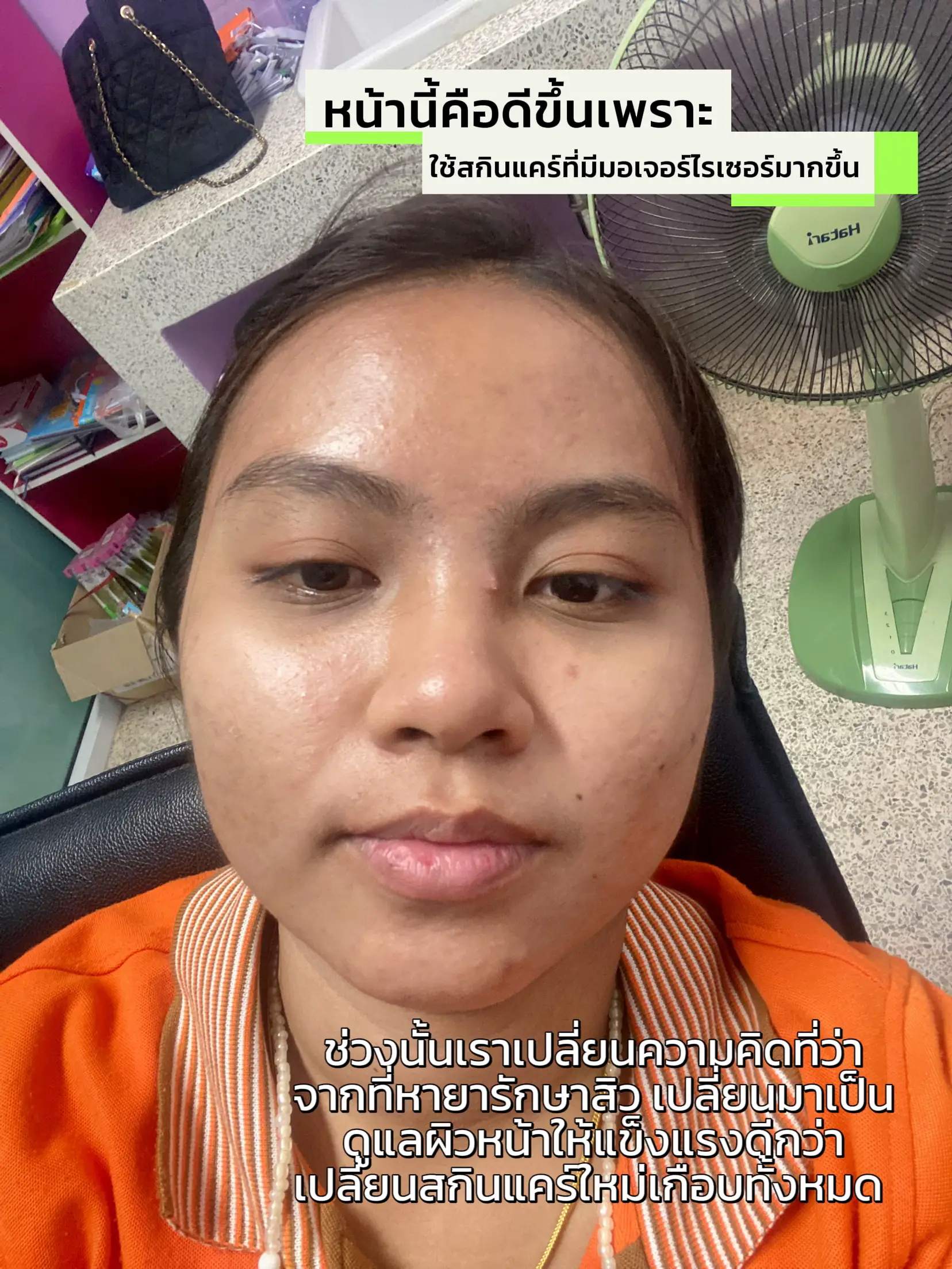 ประสบการณ์รักษาสิวด้วยตัวเอง 🫶🏻 | แกลเลอรีที่โพสต์โดย Tangmo_TM | Lemon8