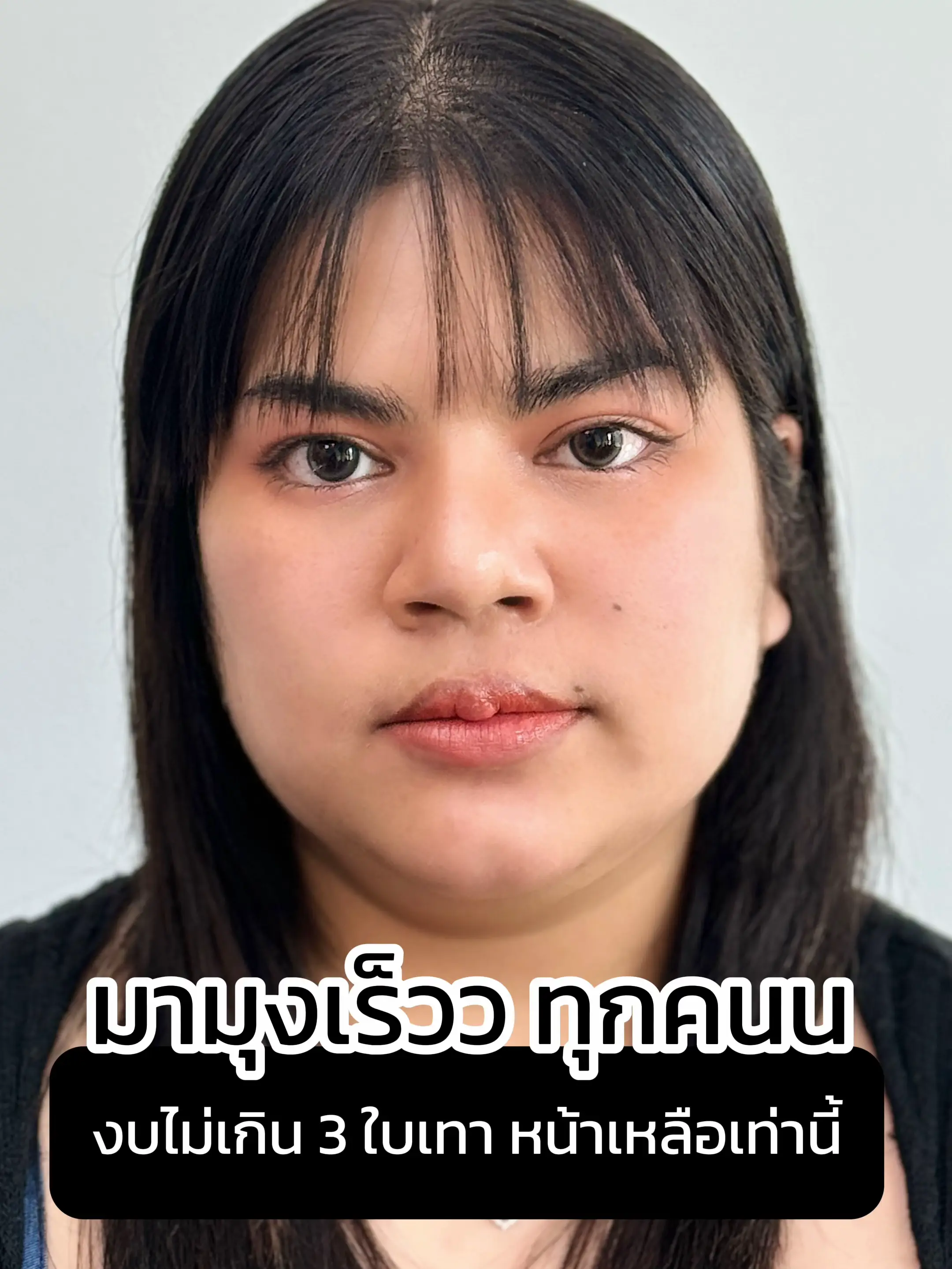 เหนียงลดลง เปลี่ยนขนาดนี้เลยหรอ?! | วิดีโอที่เผยแพร่โดย About skin | Lemon8