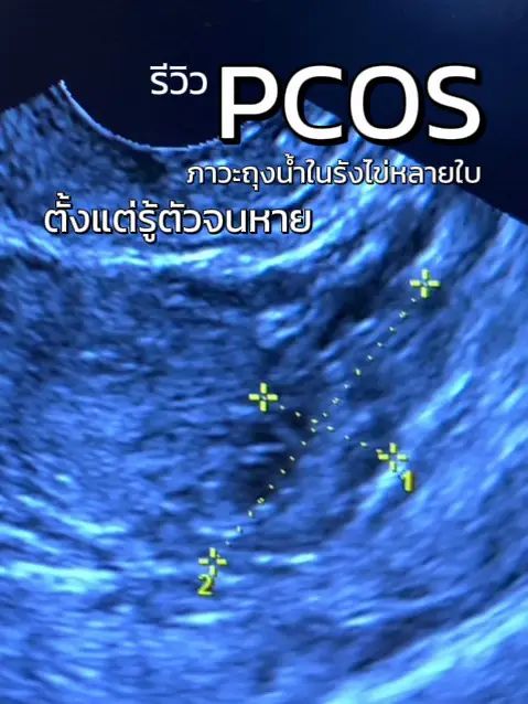 PCOS😢 | แกลเลอรีที่โพสต์โดย Sirimoko | Lemon8