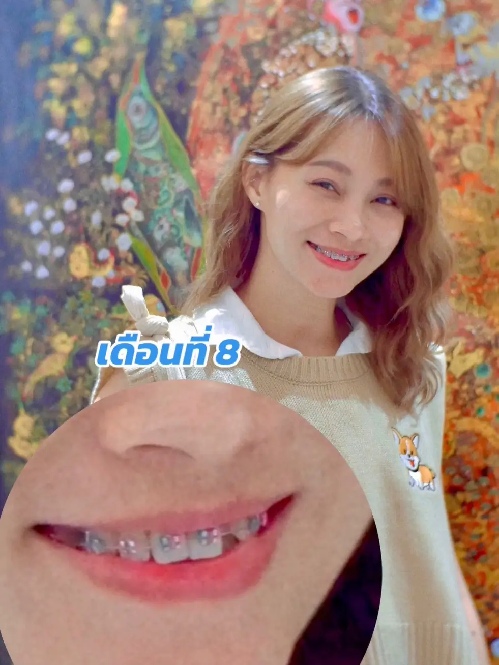 รีวิวจัดฟัน ในวัยเลข4 | แกลเลอรีที่โพสต์โดย Goonggiヅ กุ้งกิ | Lemon8