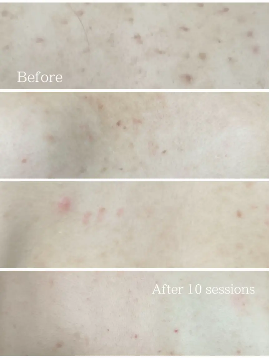 Goodbye DEEP back acne scars I had for years 🥲 | แกลเลอรีที่โพสต์โดย C ...