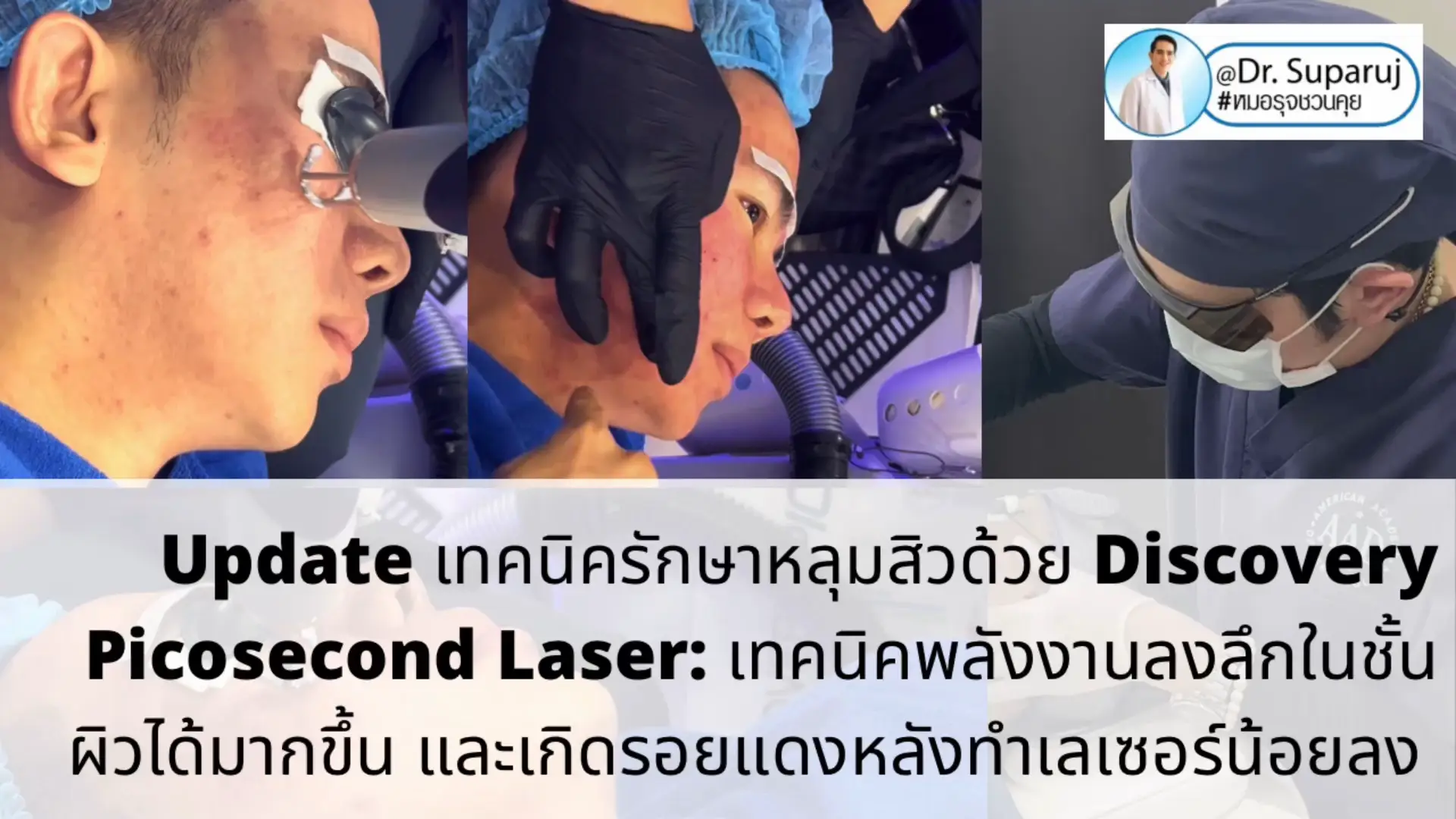 Update เทคนิคใหม่รักษาหลุมสิวด้วย Discovery Pico Laser | วิดีโอที่ ...