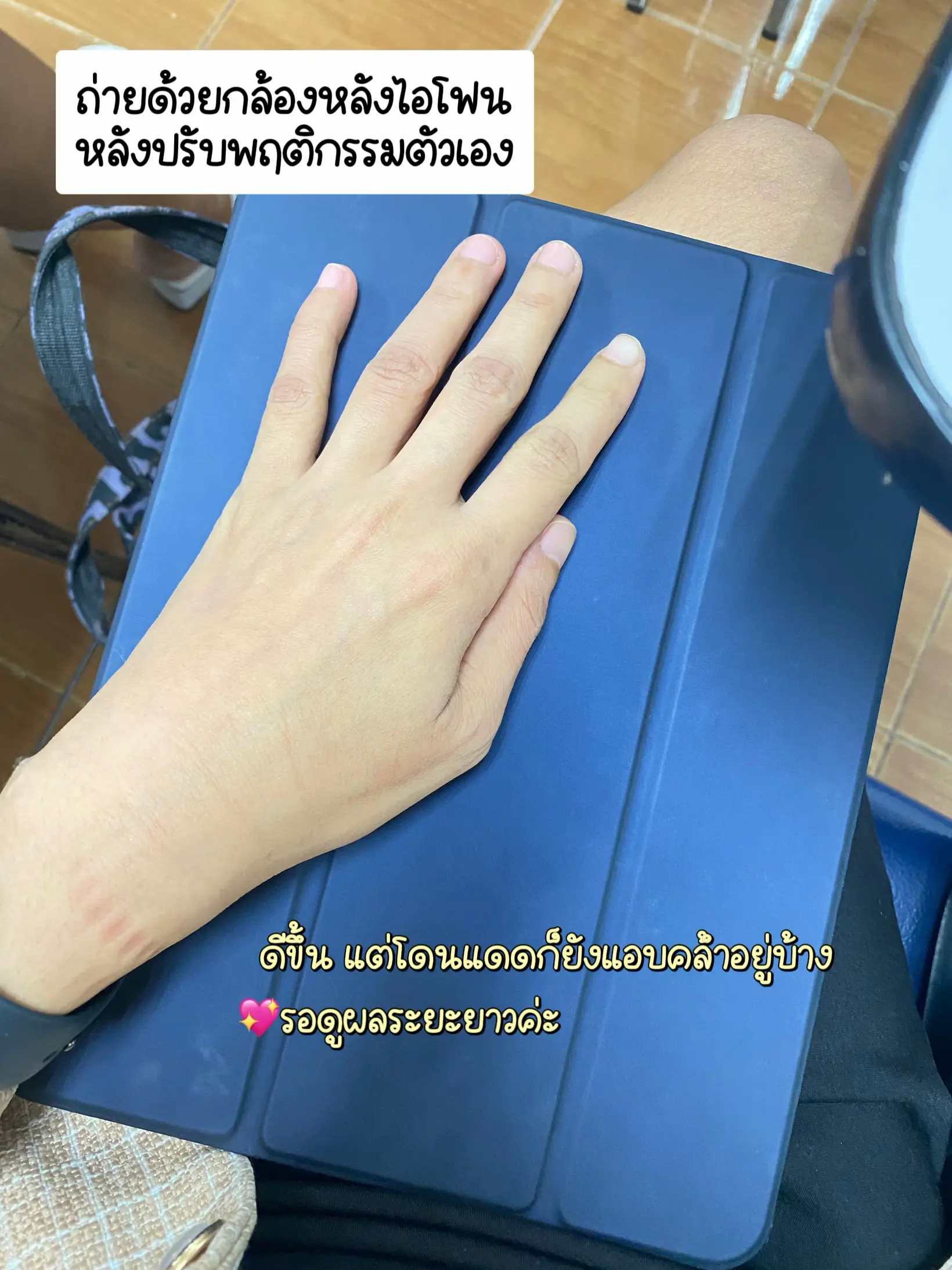 เล่าประสบการณ์ ผิวคล้ำ ไวต่อแสง และแดด!!ปัญหาที่ต้องหาทางแก้! | แกลเลอ ...
