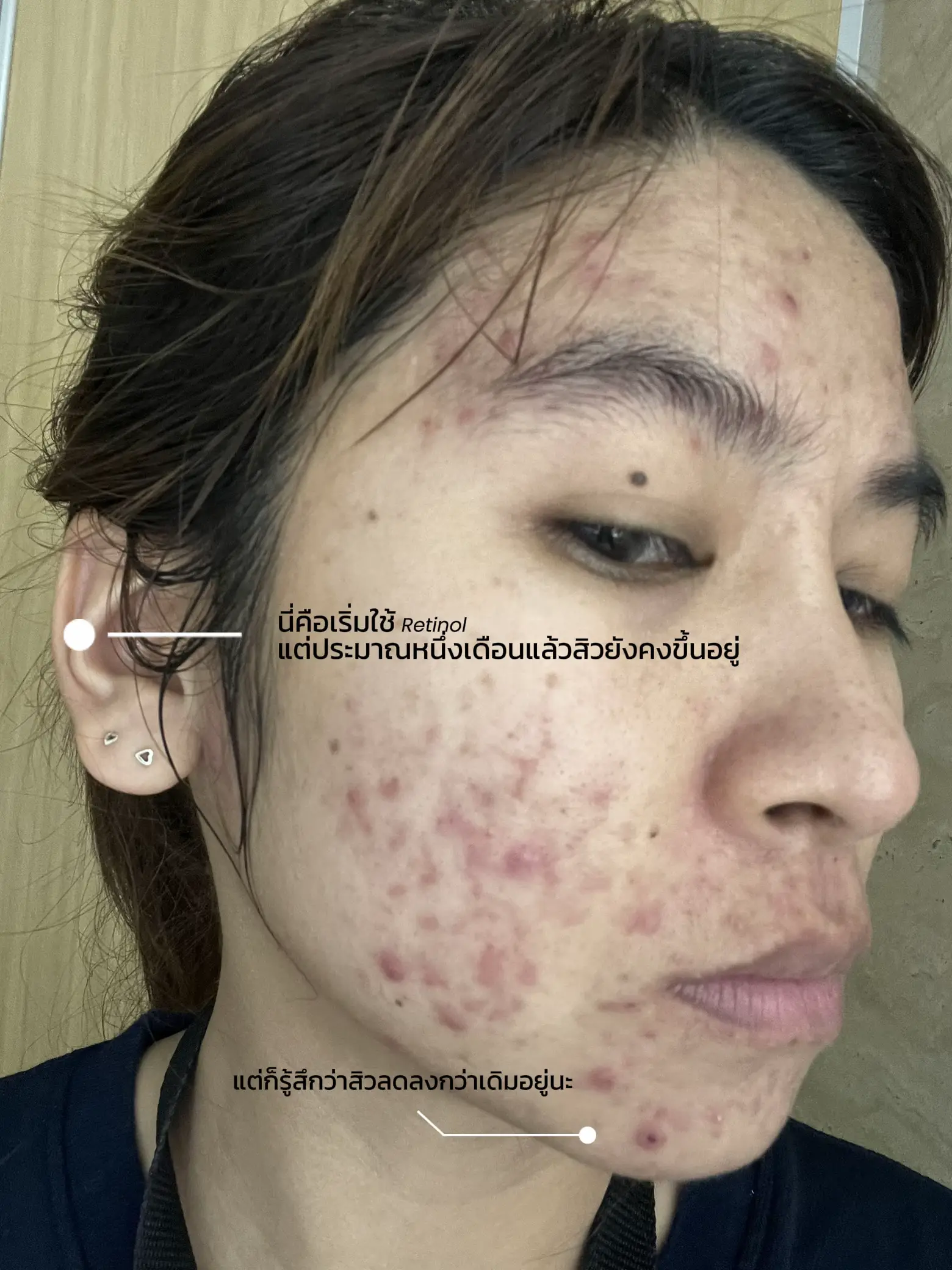 Review การใช้ Retinol แบบของแทร่ | แกลเลอรีที่โพสต์โดย ไม่กินหมู🐷 | Lemon8