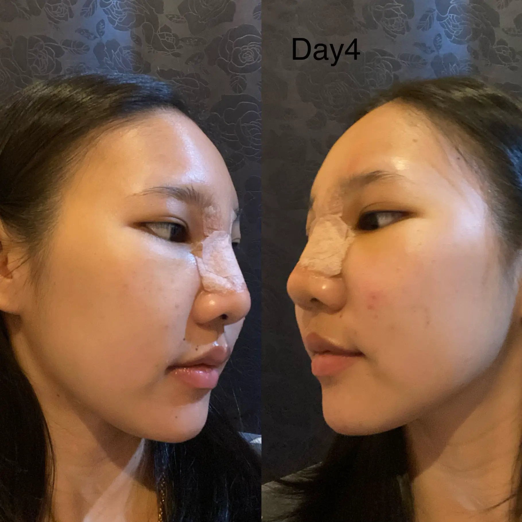 ประสบการณ์ทำจมูกครั้งแรก👃🏻 | แกลเลอรีที่โพสต์โดย Yns. | Lemon8