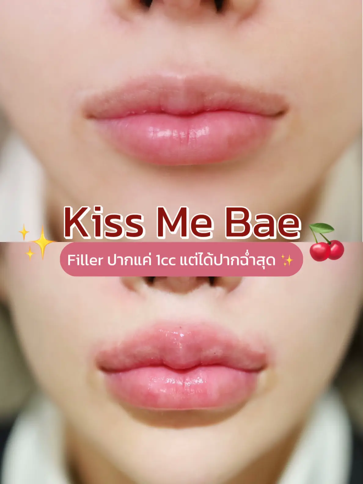 Filler ปากแค่ 1cc แต่ได้ปากฉ่ำสุด ๆ 🍒 | แกลเลอรีที่โพสต์โดย Hello muse 🪄 | Lemon8