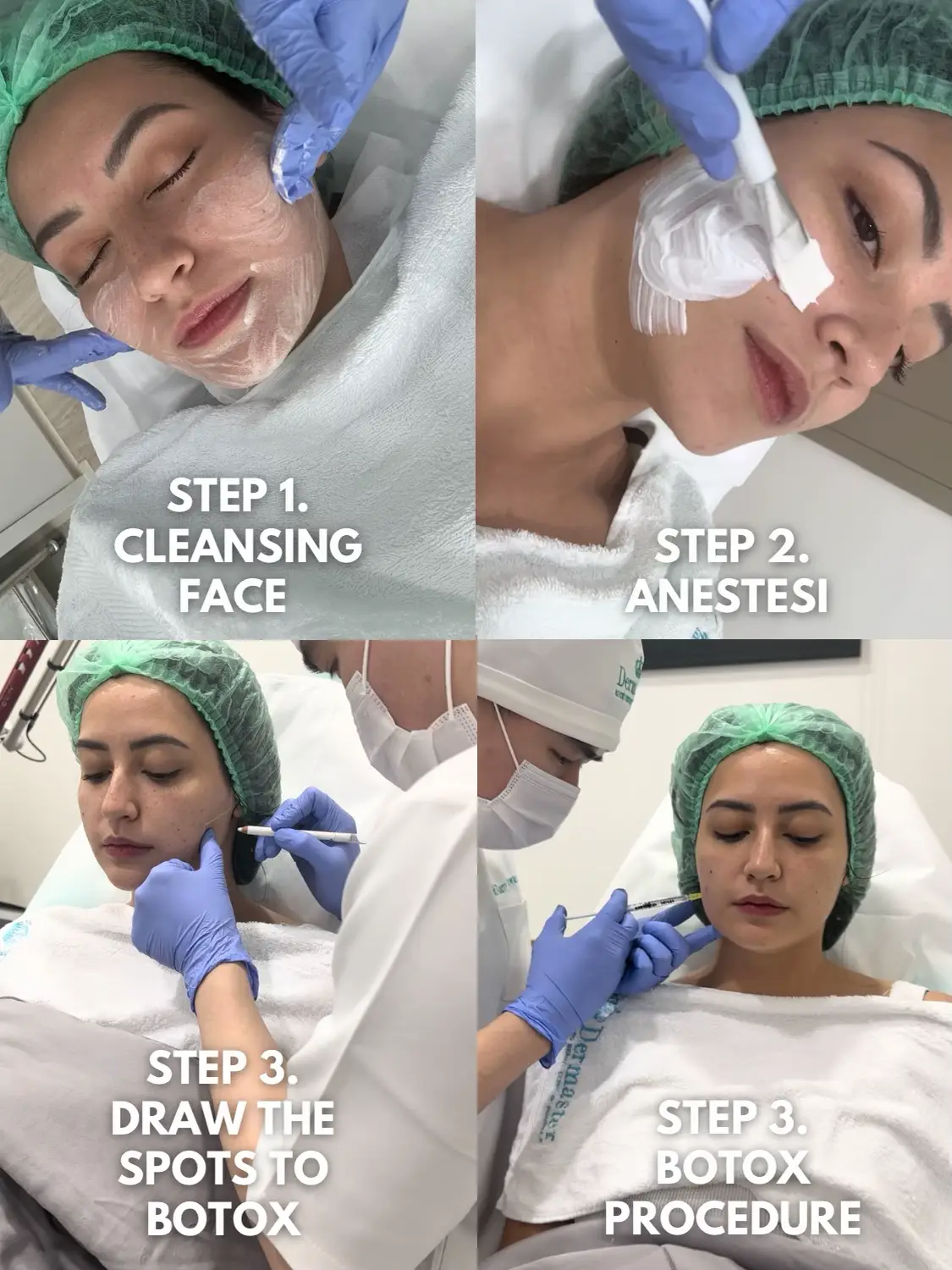 BOTOX RAHANG REVIEW AND RESULT! 🤩 | Galeri diposting oleh mutiarahazle ...