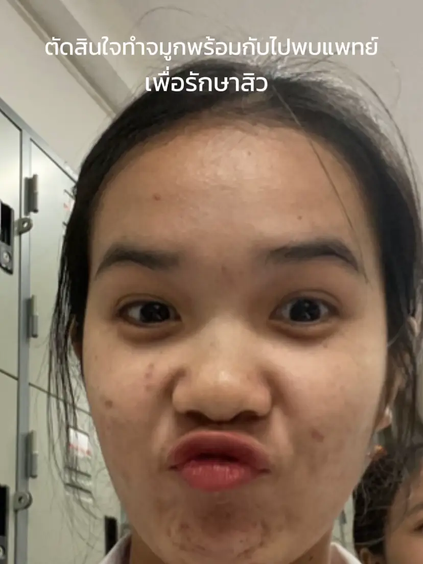 รีวิวศัลยกรรมครั้งแรก+รักษาสิว💊👃🏻🩸 | แกลเลอรีที่โพสต์โดย kanphitcha | Lemon8