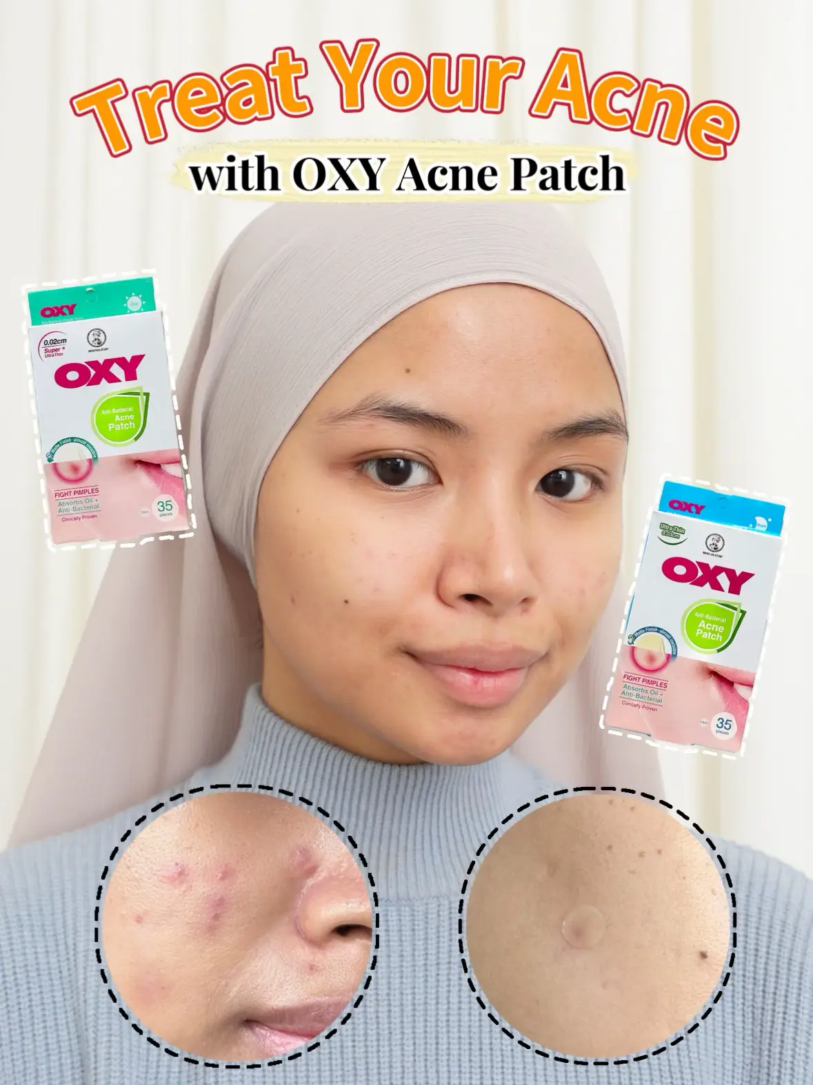 Cover Acne Properly! | แกลเลอรีที่โพสต์โดย Fara Juliana | Lemon8