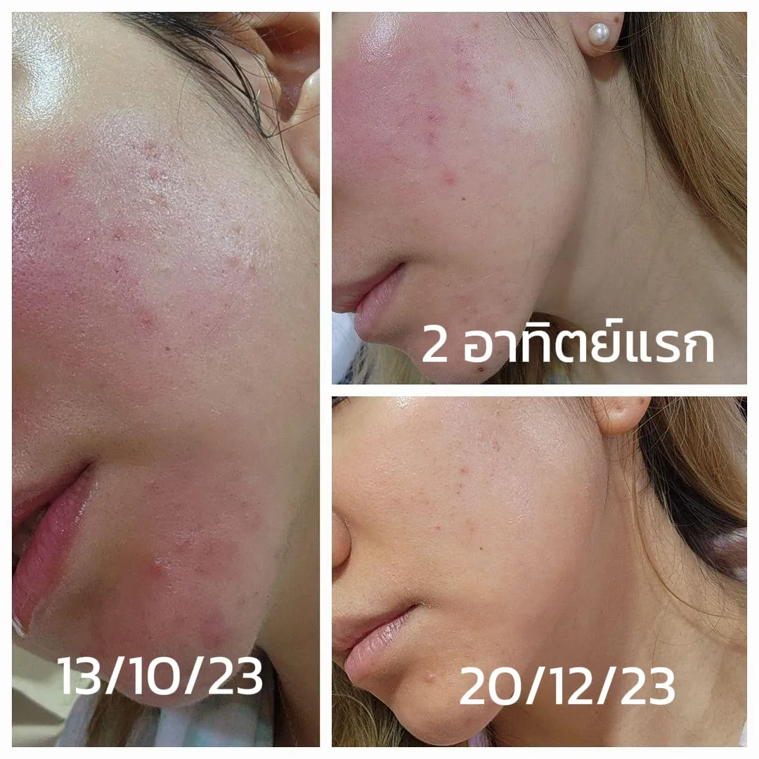 รักษาสิวด้วย Differin 2 เดือนนิดๆ | แกลเลอรีที่โพสต์โดย Annayanisa | Lemon8