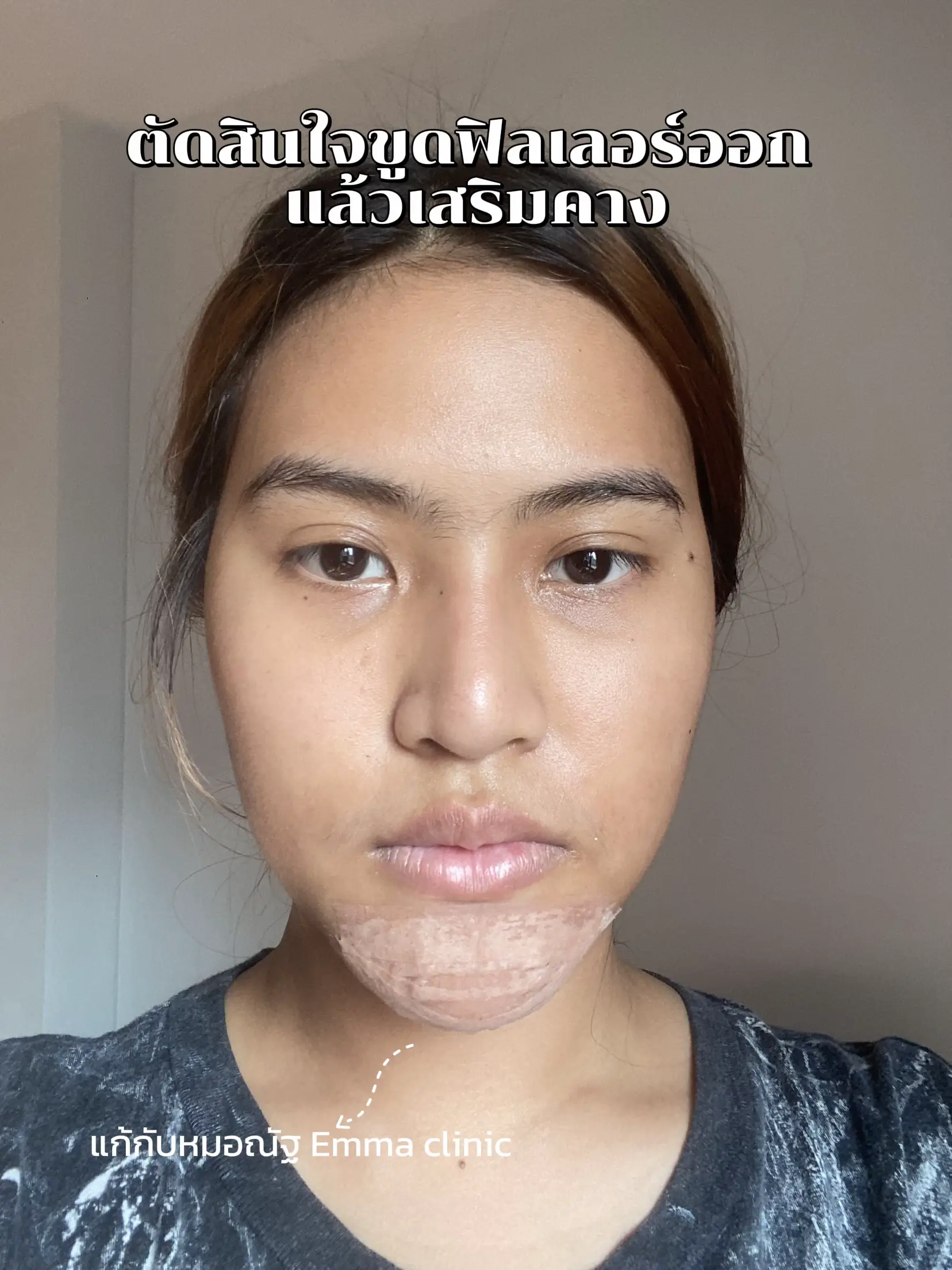 ฉีดฟิลเลอร์มาแล้วพัง!!!! | แกลเลอรีที่โพสต์โดย Jaranin Jin | Lemon8