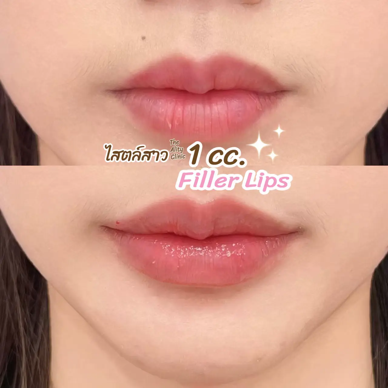 รีวิวปาก 1 cc สไตล์The Ality clinic 🍋😍 | แกลเลอรีที่โพสต์โดย Beer ...