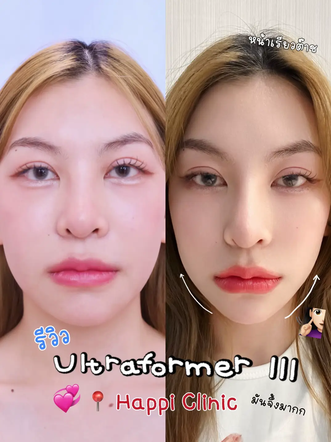 ว่าด้วยเรื่องหน้าเรียว!! 🧏🏻‍♀️ ️💫 – Ultraformer III | แกลเลอรีที่โพสต์โดย Happi Clinic | Lemon8