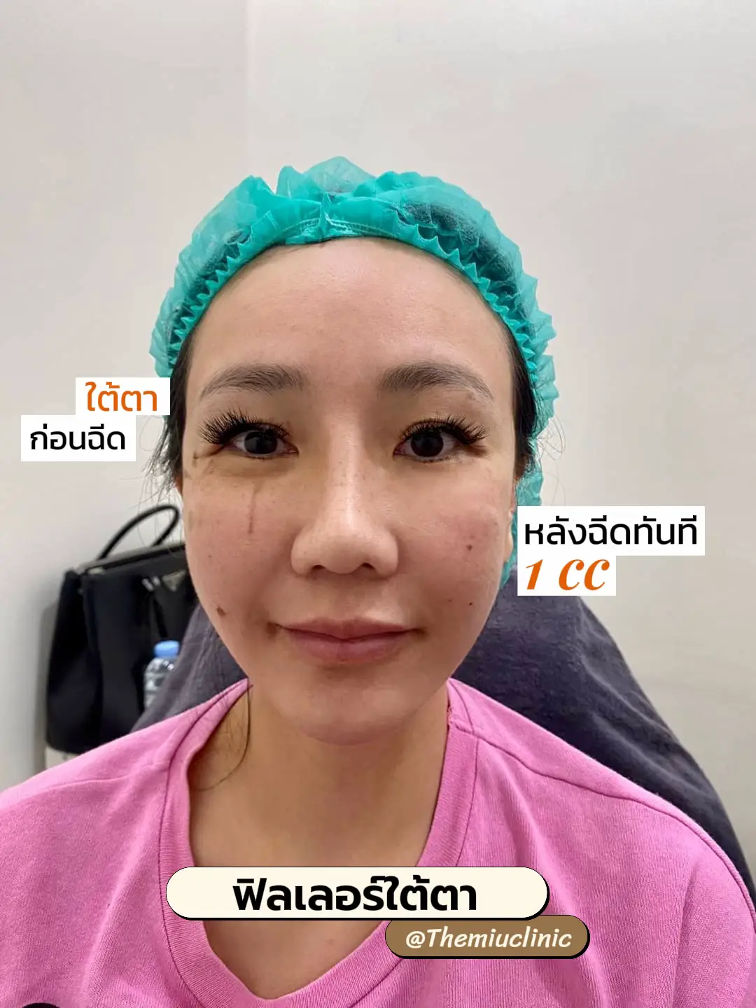 1 cc | แกลเลอรีที่โพสต์โดย MiU MiU | Lemon8