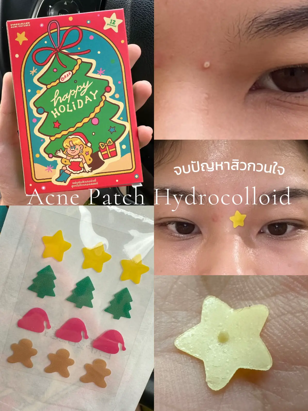Acne Patch Hydrocolloid Acne Patch Hydrocolloid