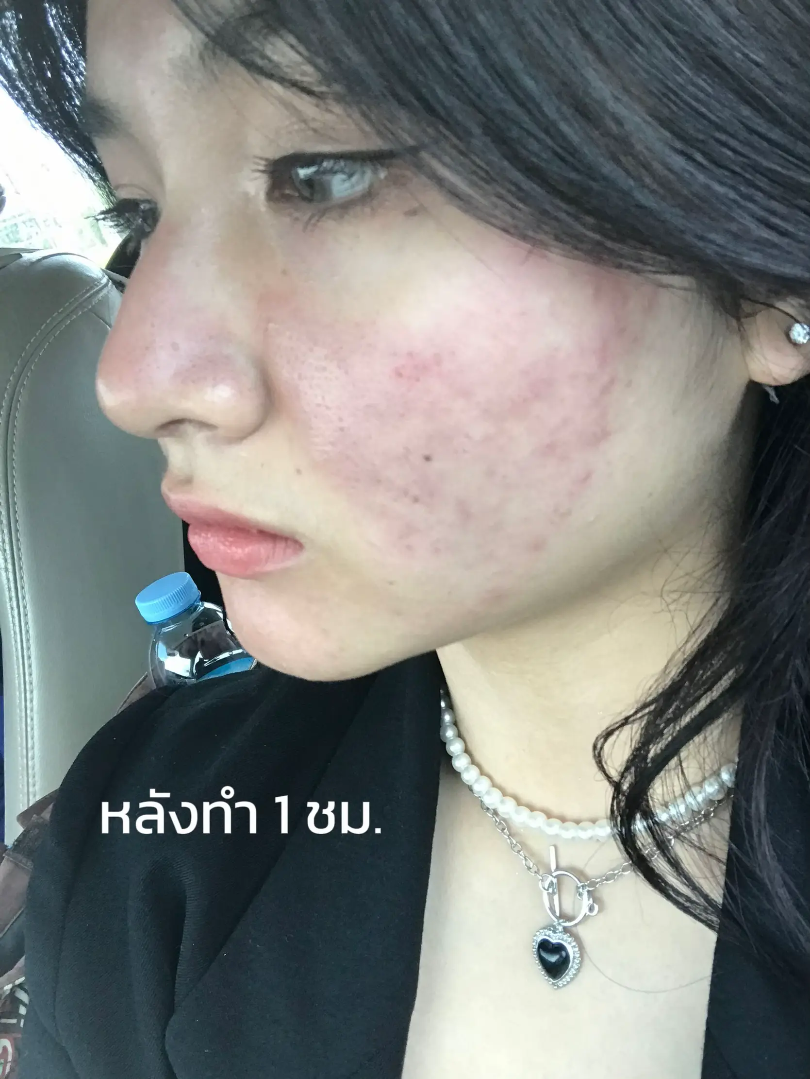 รีวิว Pico laser แบบพลีชีพ!! | แกลเลอรีที่โพสต์โดย nws_pancake | Lemon8