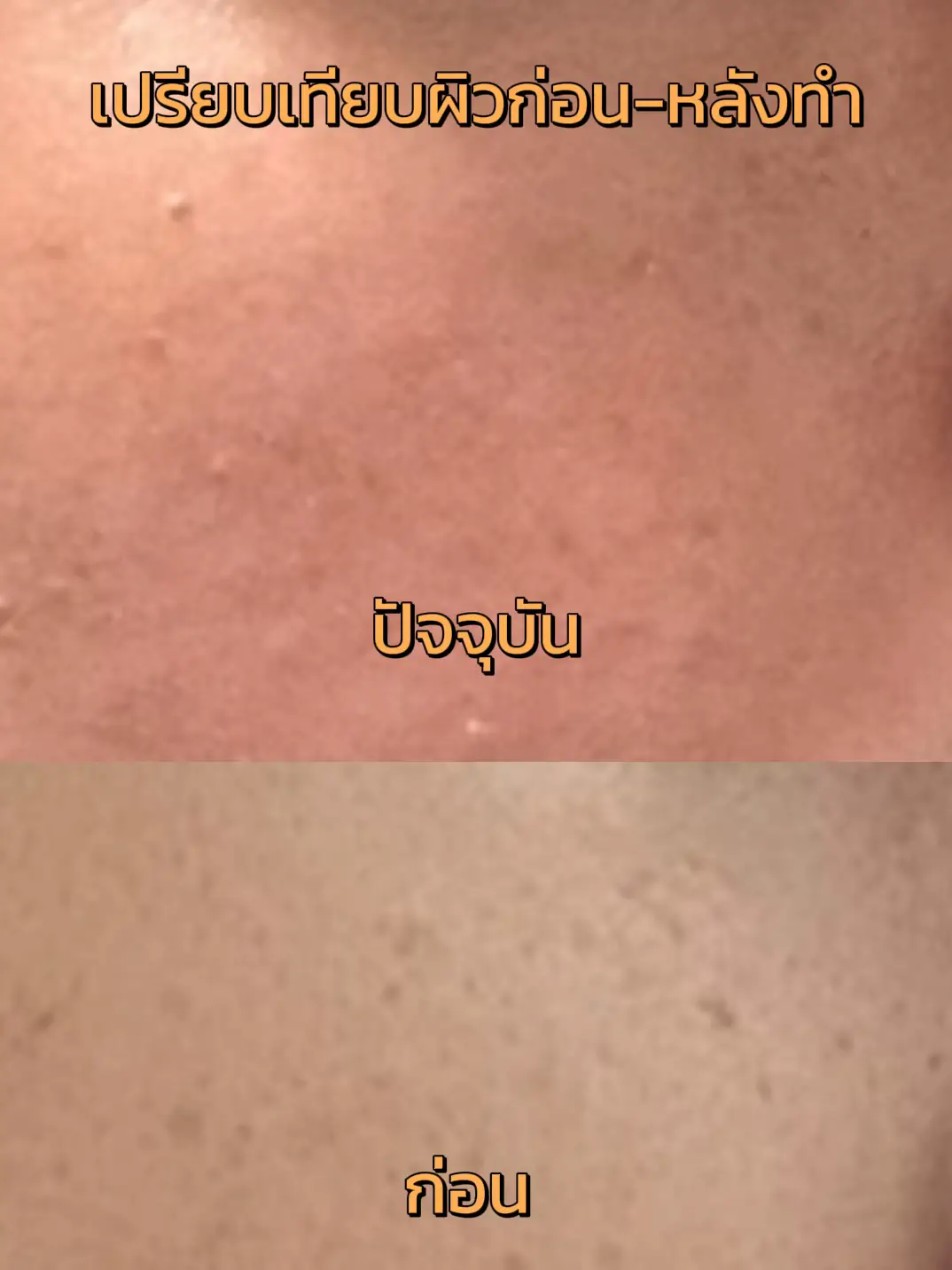 Review ทำ Pico ที่ Prime Aesthetics | แกลเลอรีที่โพสต์โดย Hello._.noon ...