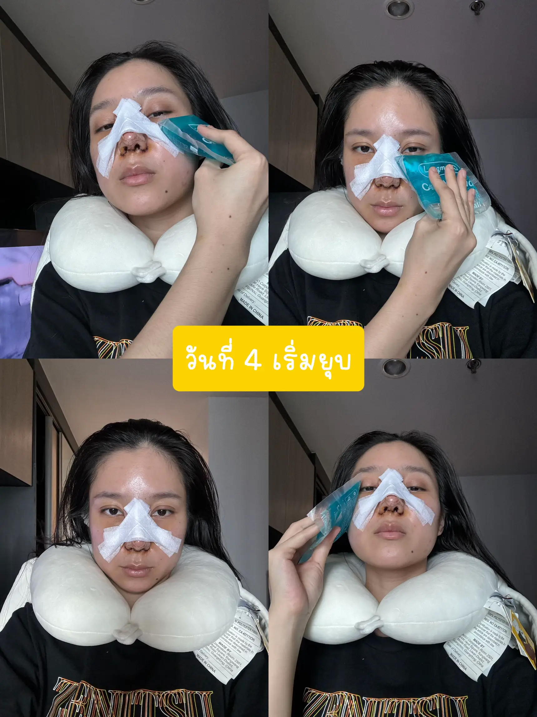 พรีชีพ ครั้งแรก เสริมจมูก full open+กระดูกหลังหู no spon | แกลเลอรีที่ ...