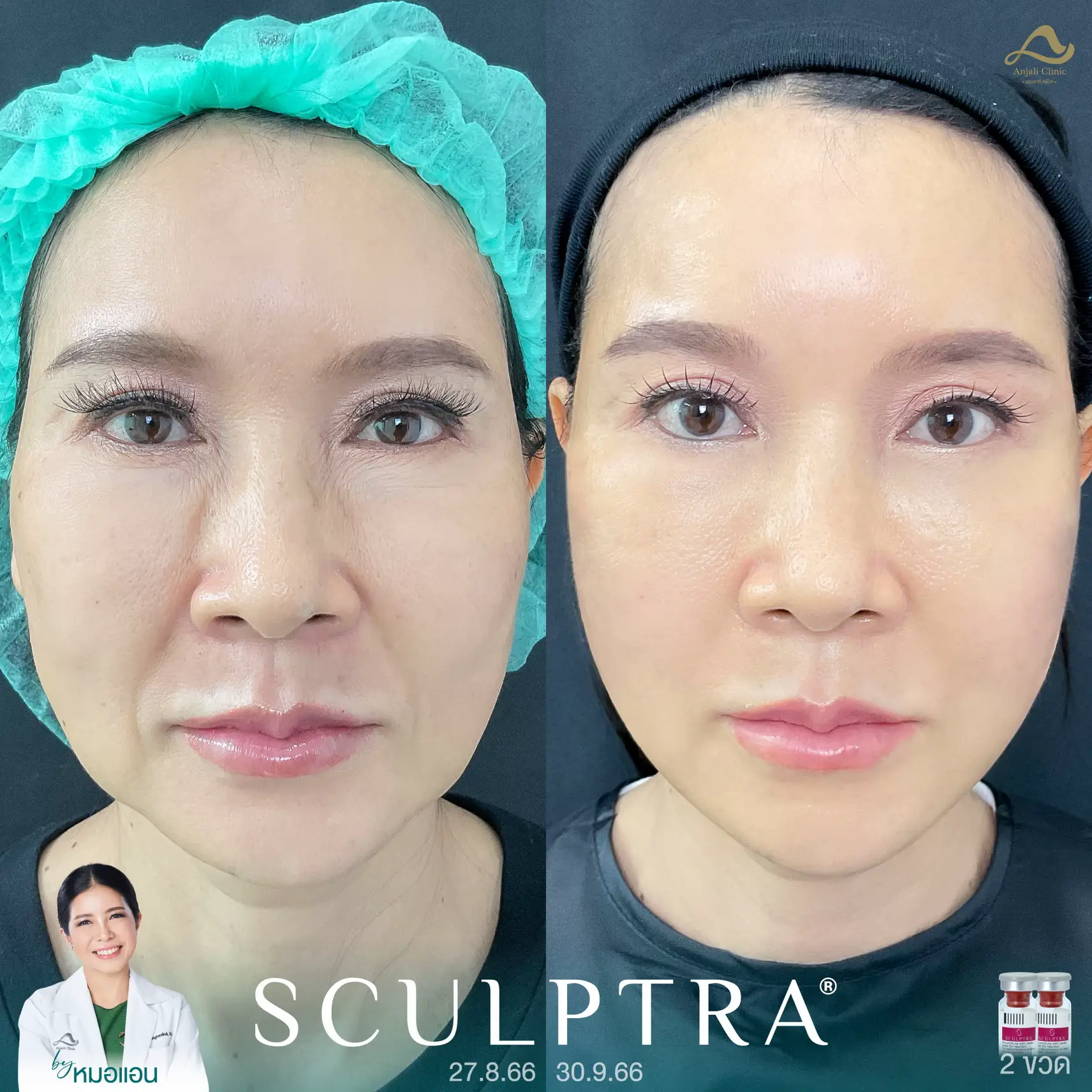 Sculptra ย้อนวัย 10 ปี โม้เปล่า !?! | แกลเลอรีที่โพสต์โดย Anjali Clinic | Lemon8