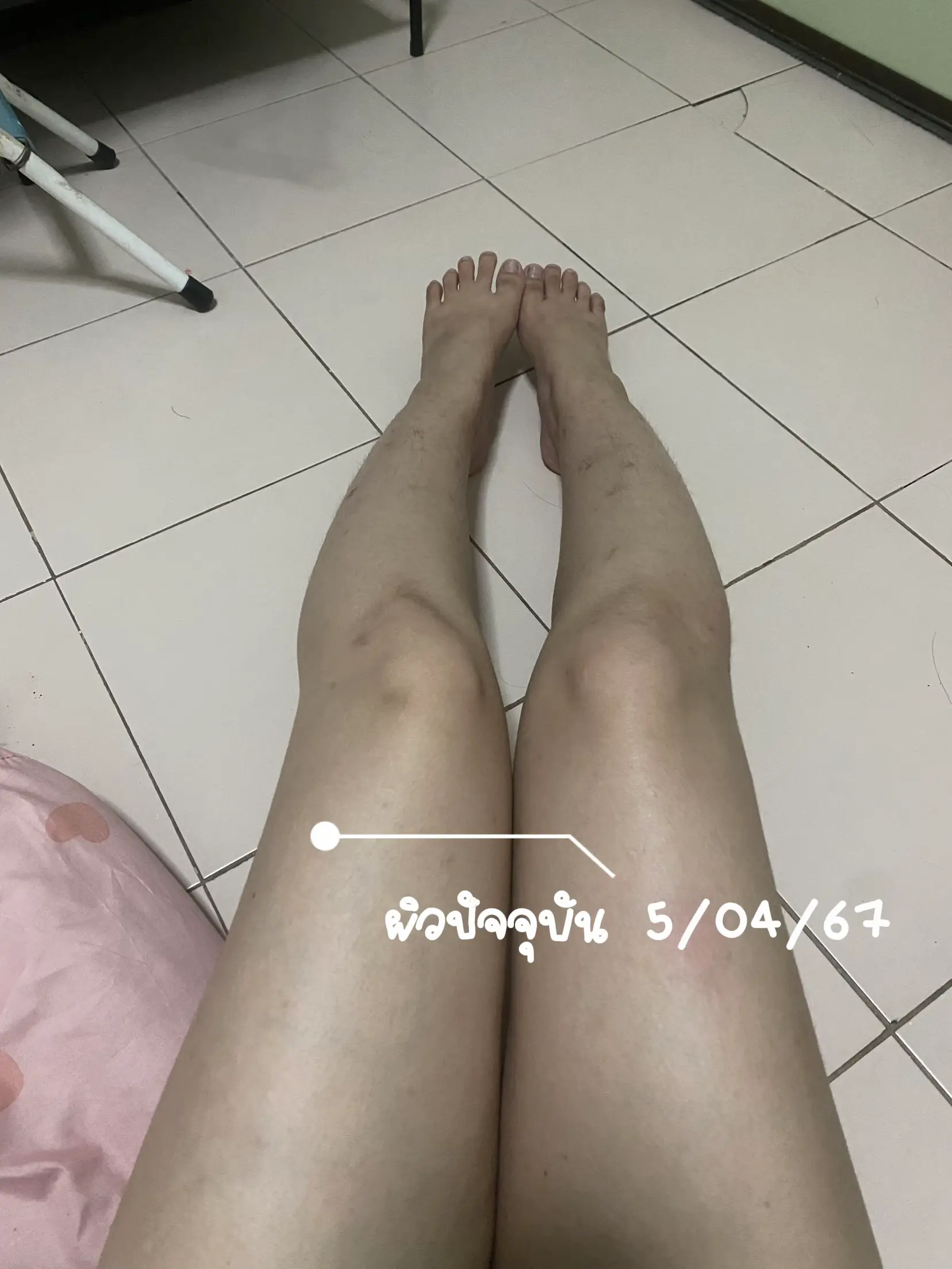 ขาลาย รอยดำรอยแผลเป็น ดูแลยังไงดี?? | แกลเลอรีที่โพสต์โดย Kwa.Land | Lemon8