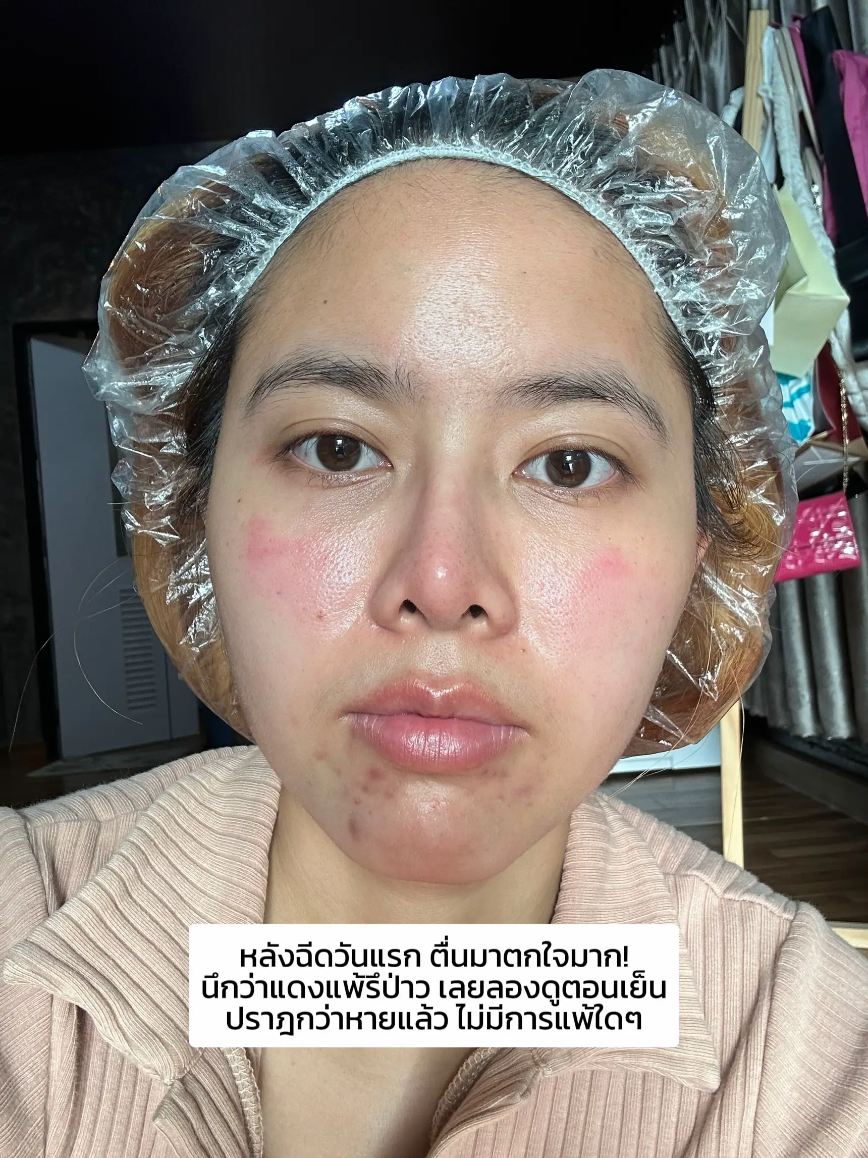 ฉีดชาแนลดียังไง ? ใครที่ต้องทำ ? ‼️🔥 | แกลเลอรีที่โพสต์โดย ssompns | Lemon8