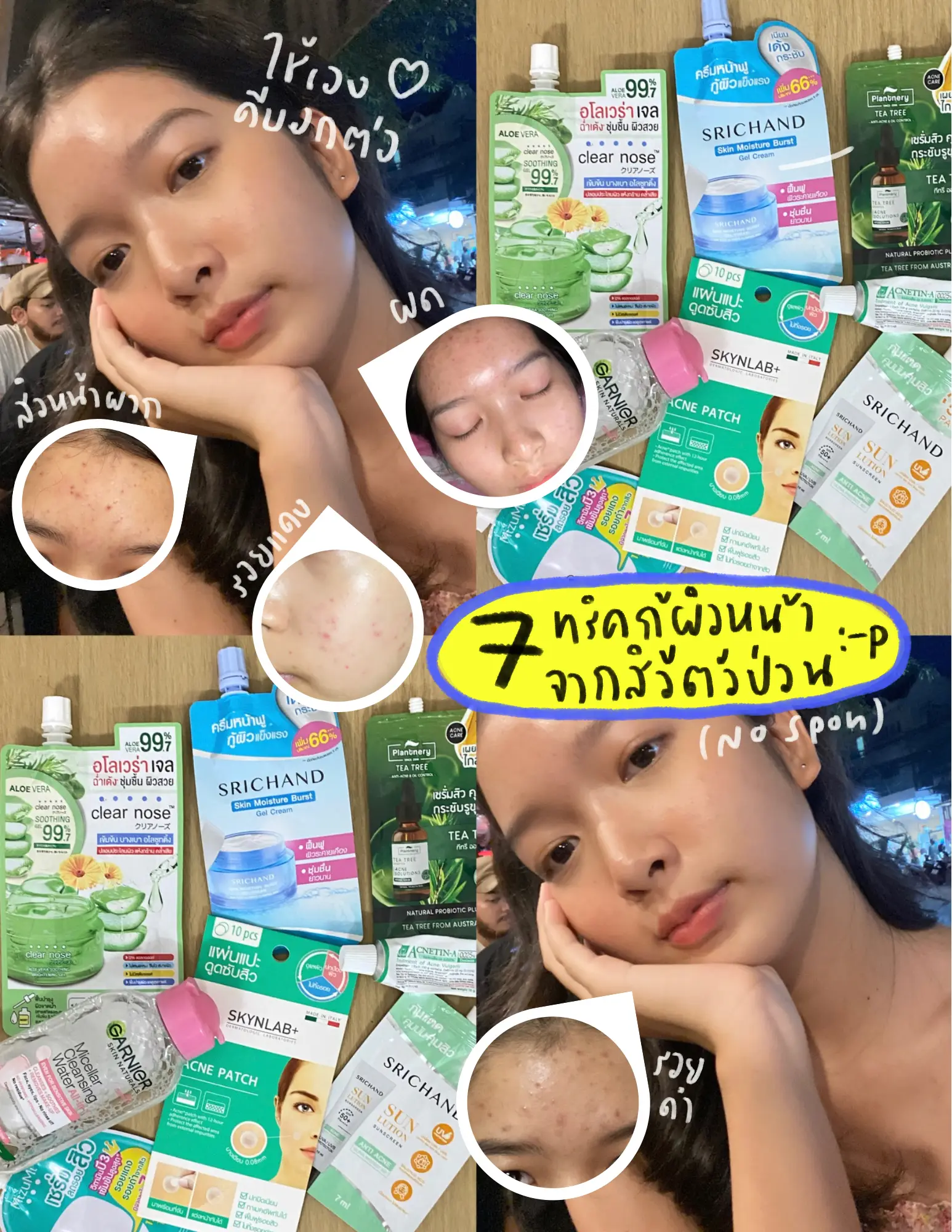 Ep.1 กู้สิวเห่อ ภายใน7วัน! (No Spon) | แกลเลอรีที่โพสต์โดย ffernfk | Lemon8