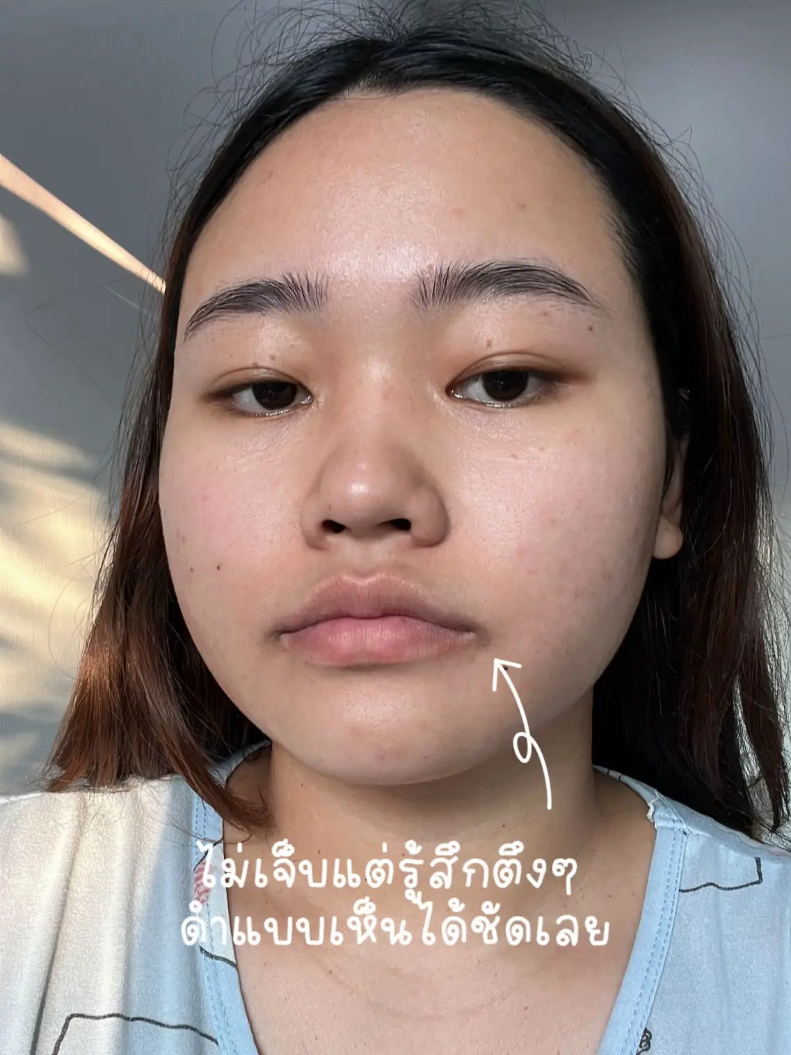 มุมปากดำเกิดจากอะไร ทำยังไงให้หาย?? | แกลเลอรีที่โพสต์โดย sha ma share | Lemon8