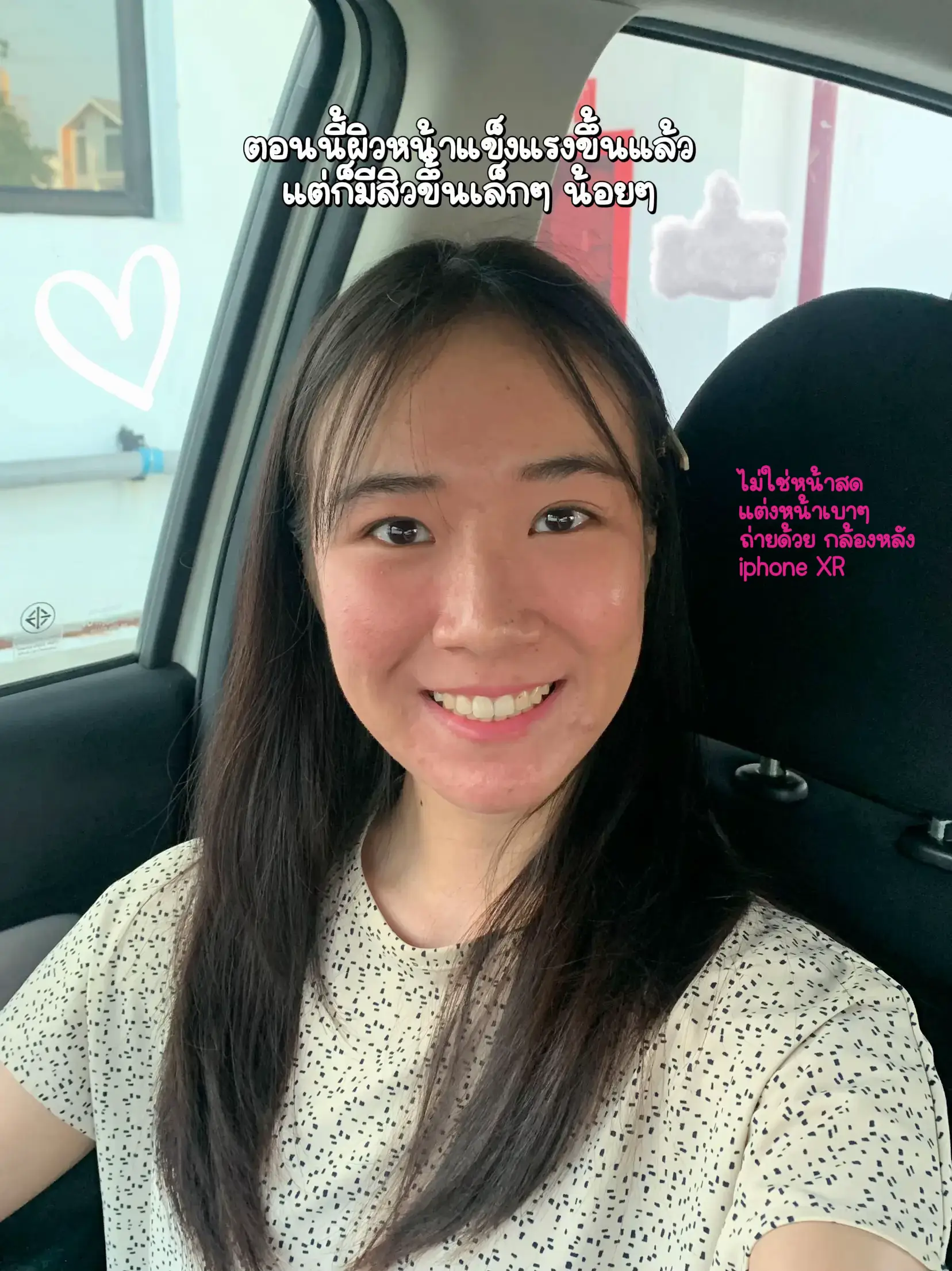 EP1 พลีชีพสิวหนองขึ้นเต็ม! | แกลเลอรีที่โพสต์โดย Iamnanamo | Lemon8