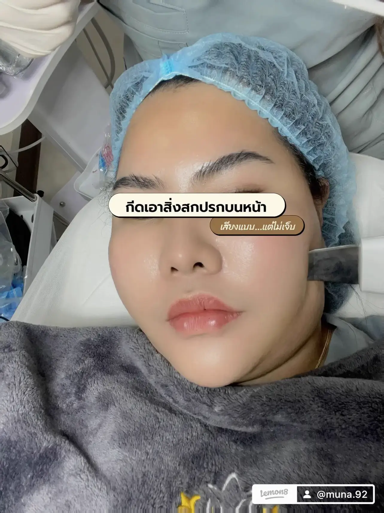 รักษาสิวแบบ 4ขั้นตอน | แกลเลอรีที่โพสต์โดย MUNA | Lemon8