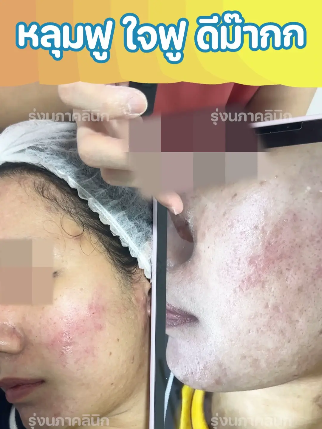 หลุมฟู ใจฟู รับปรใหม่ 2024 | วิดีโอที่เผยแพร่โดย Dr.Ploy รุ่งนภา | Lemon8