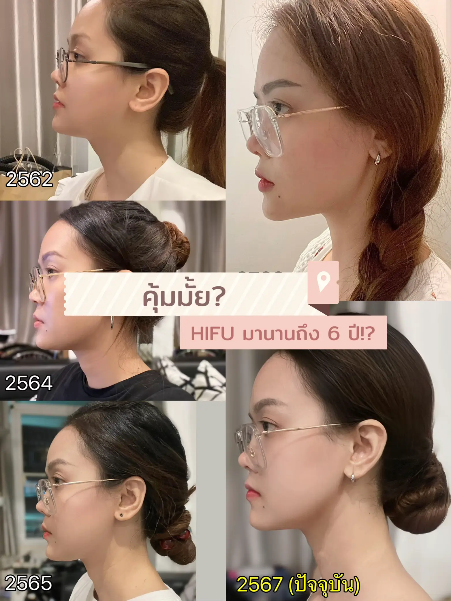 Premium Hifu สองแบ้งค์เทามีทอน เห็นผลจริง😱😱 | แกลเลอรีที่โพสต์โดย ตอเต่าป้ายยา💋👊🏻 | Lemon8