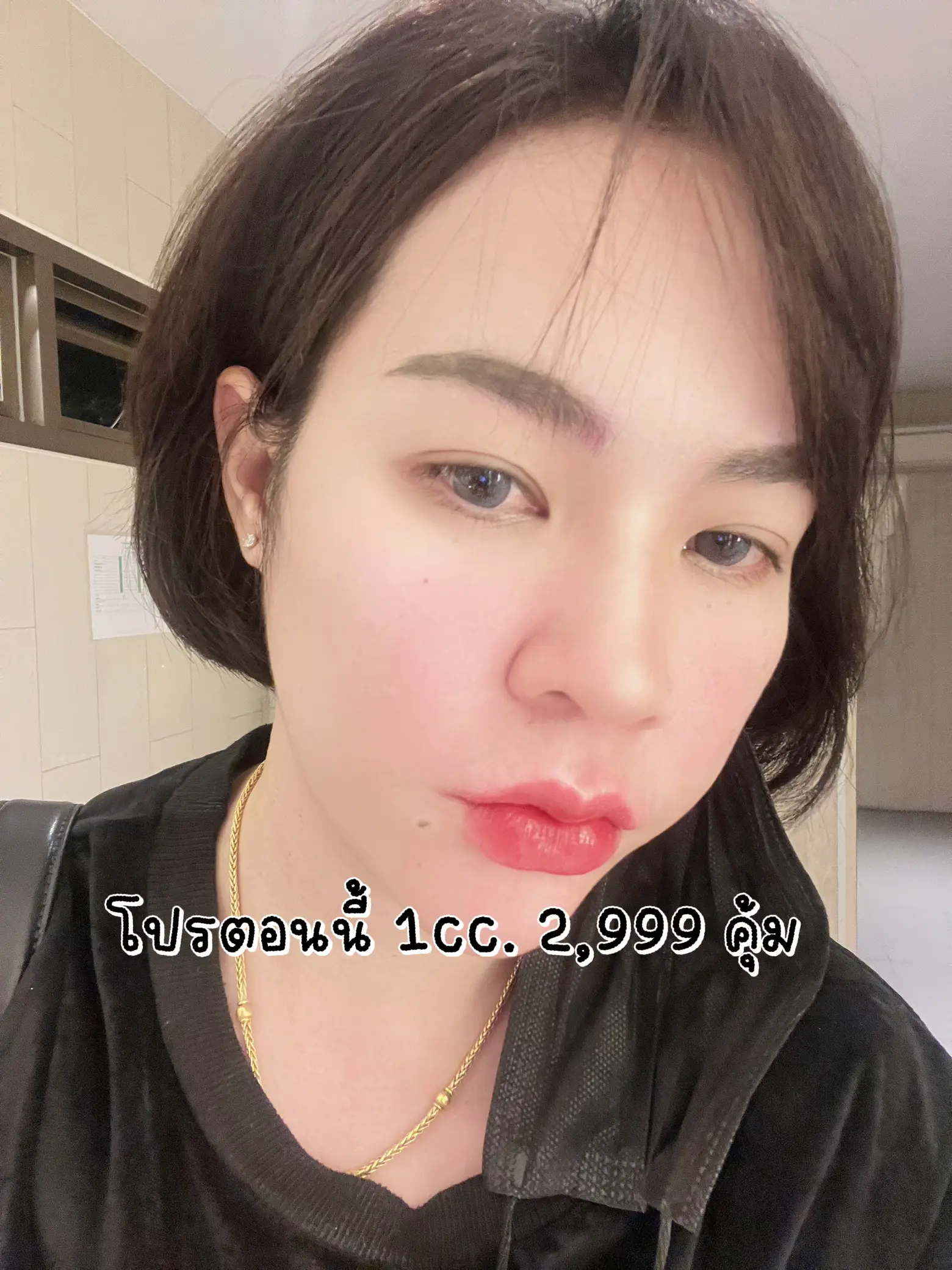 มือใหม่ฉีดฟิลเลอร์ครั้งแรก ขอ1 ซีซีก่อนค่ะหมอ | แกลเลอรีที่โพสต์โดย Ma riam | Lemon8