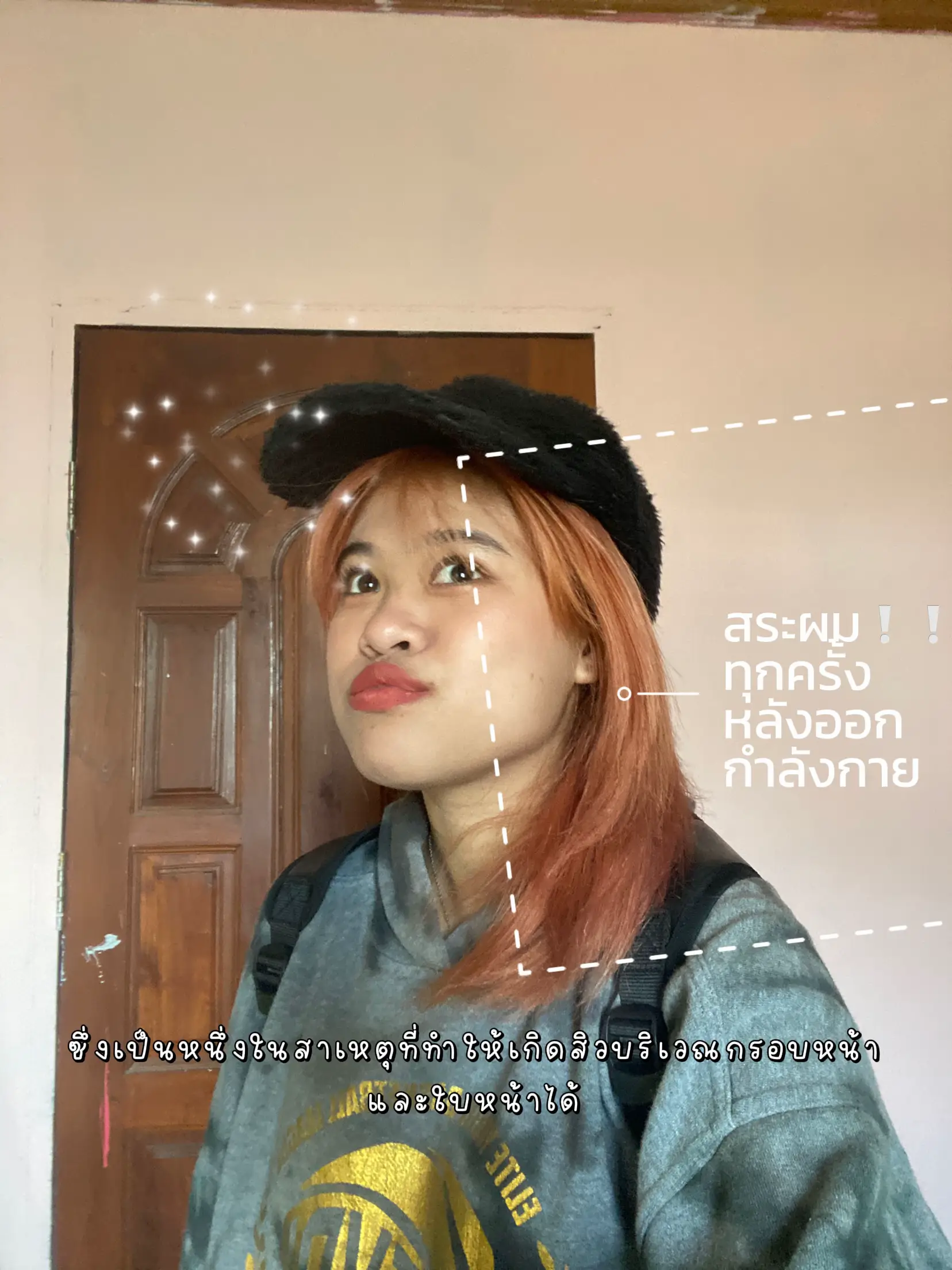 ห่างไกลสิว | แกลเลอรีที่โพสต์โดย Grape garbel | Lemon8