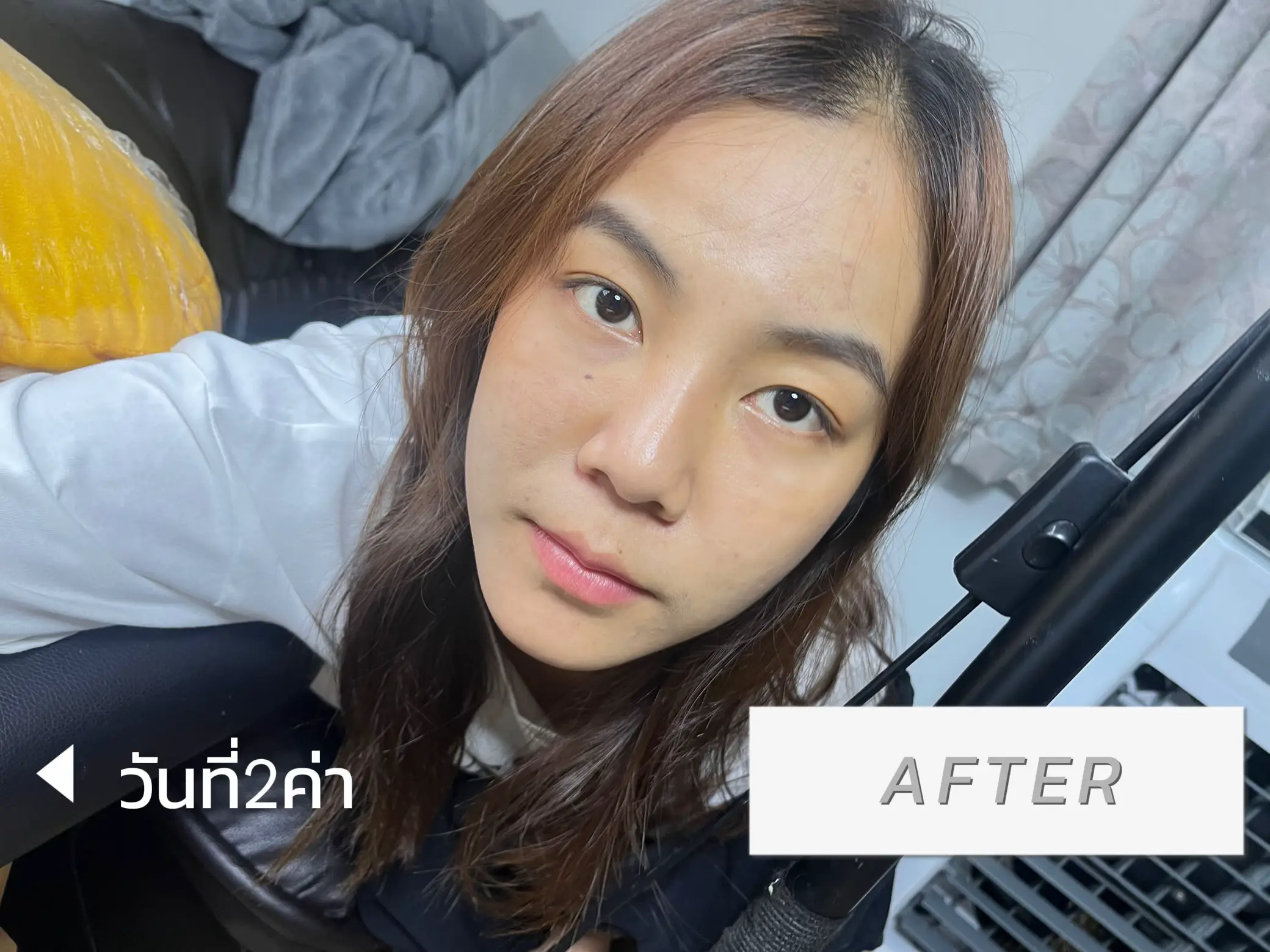 ฉีดรีจูรัน เจ็บไหม ดีจริงไหม ?🧐💉 | แกลเลอรีที่โพสต์โดย kamon | Lemon8