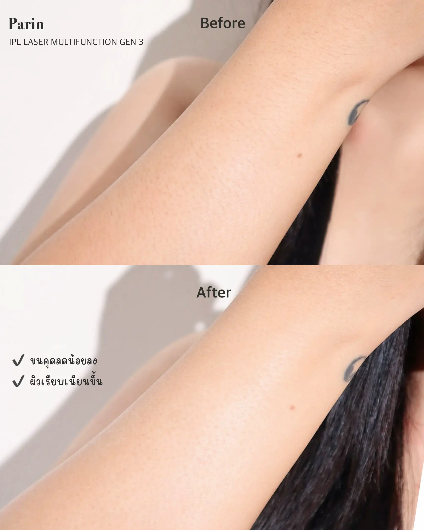 คนขนดกเชิญมามุง รีวิว PARIN IPL GEN 3 ฉบับคนขนเยอะ มีขน | แกลเลอรีที่โพสต์โดย kanoonsrv | Lemon8