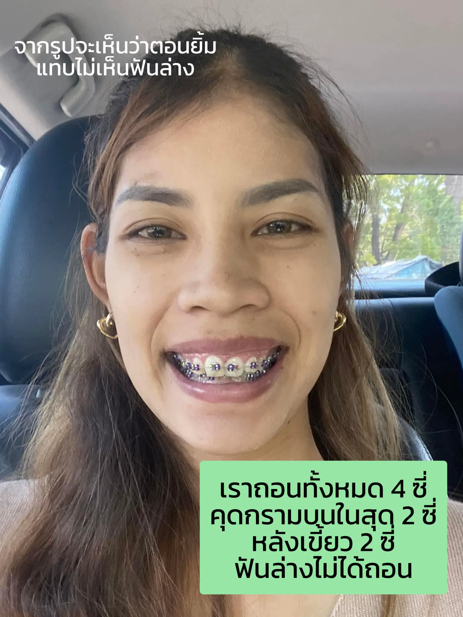 จัดฟันครบ 1 ปีแล้ว มีอะไรเปลี่ยนไปบ้าง? | แกลเลอรีที่โพสต์โดย Ratchaporn Sinm | Lemon8