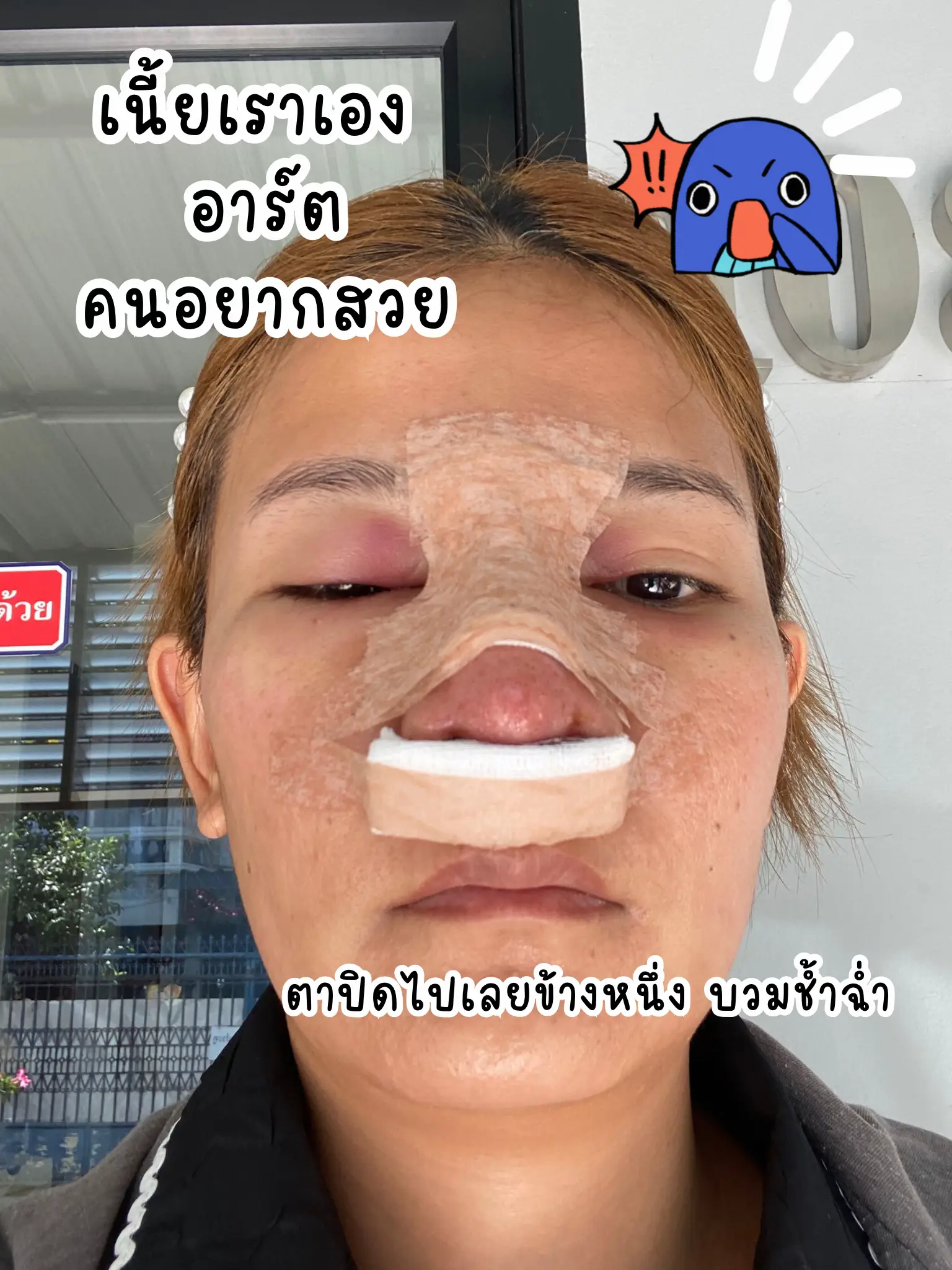 ลดบวม Proctase-P คือ ยา แก้ อะไร - การค้นหาใน Lemon8