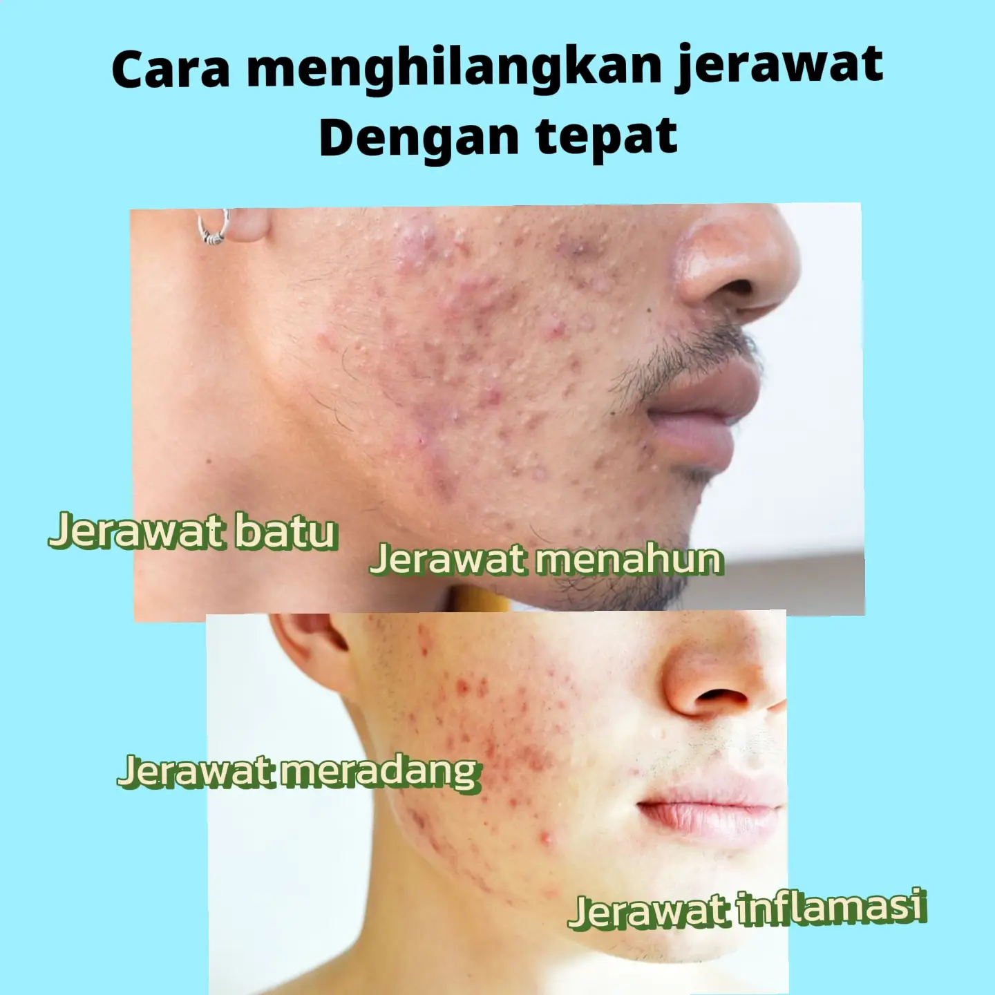 CARA MENGHILANGKAN JERAWAT | Galeri diposting oleh Beauty Care | Lemon8