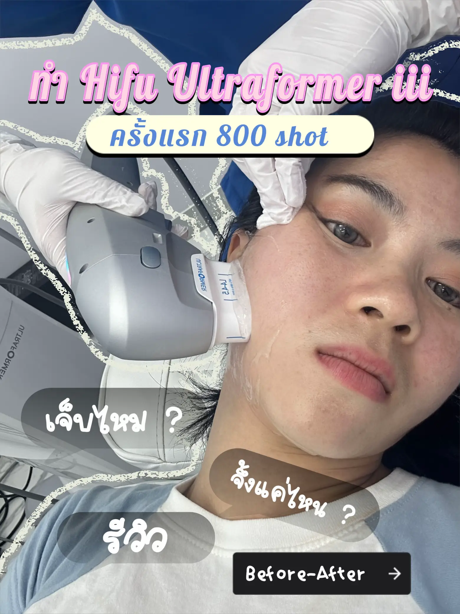 face check ทำ Hifu Ultraformer iii 800 Shot !!! | แกลเลอรีที่โพสต์โดย jullet🦦 | Lemon8