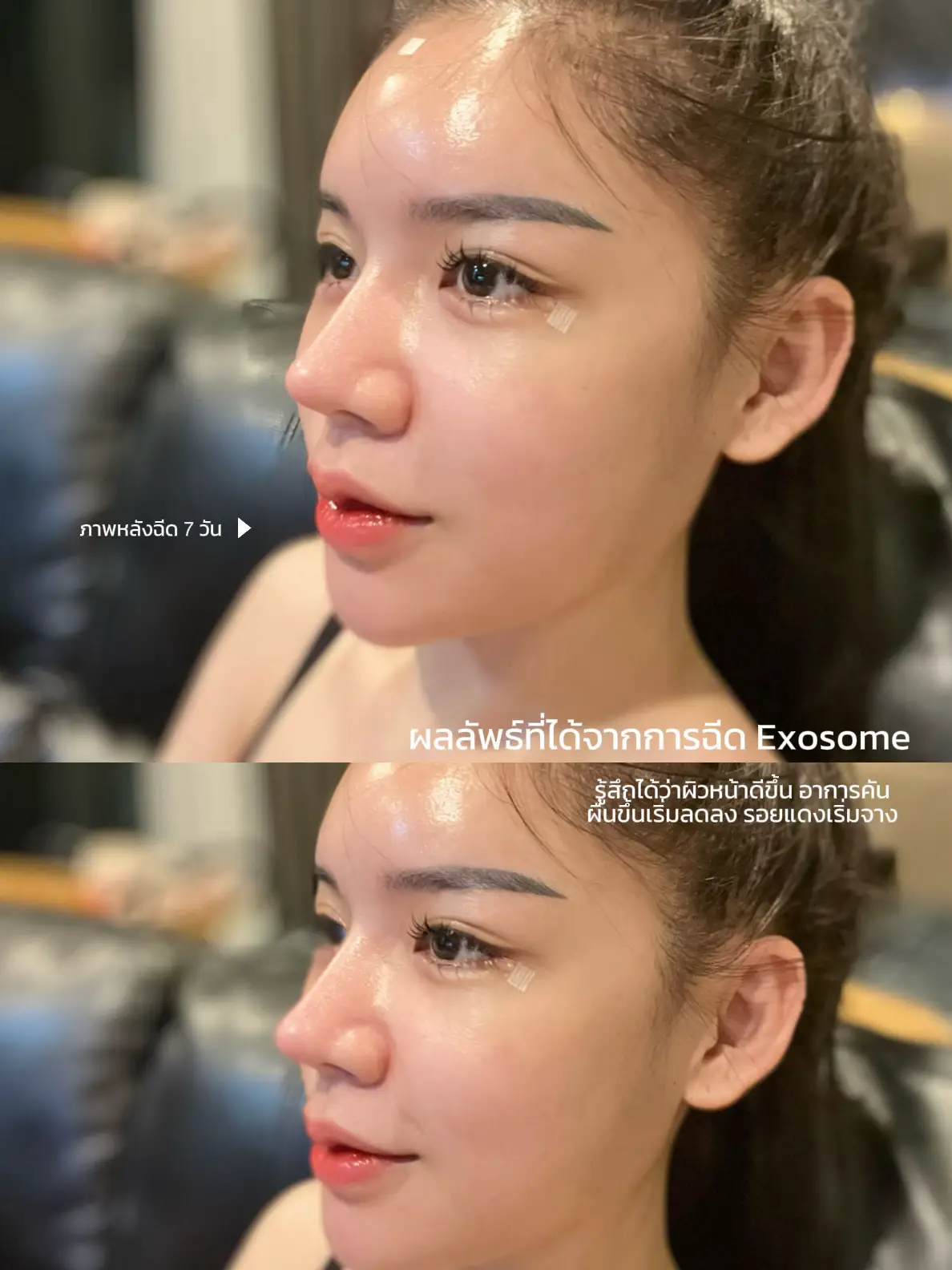 💠Exosome ดียังไง ⁉️ | แกลเลอรีที่โพสต์โดย Saiparn | Lemon8