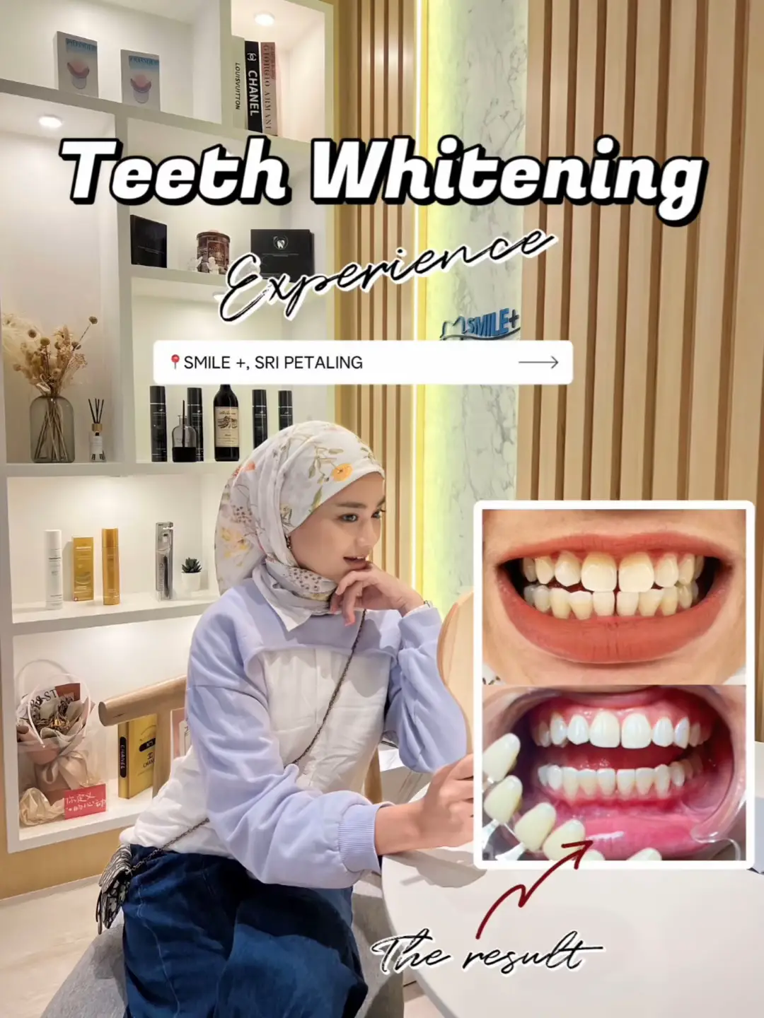 GIGI INSTANT PUTIH DENGAN HANYA 1 KALI TREATMENT🦷😱 | Video dipublikasikan oleh Aishah.exe | Lemon8