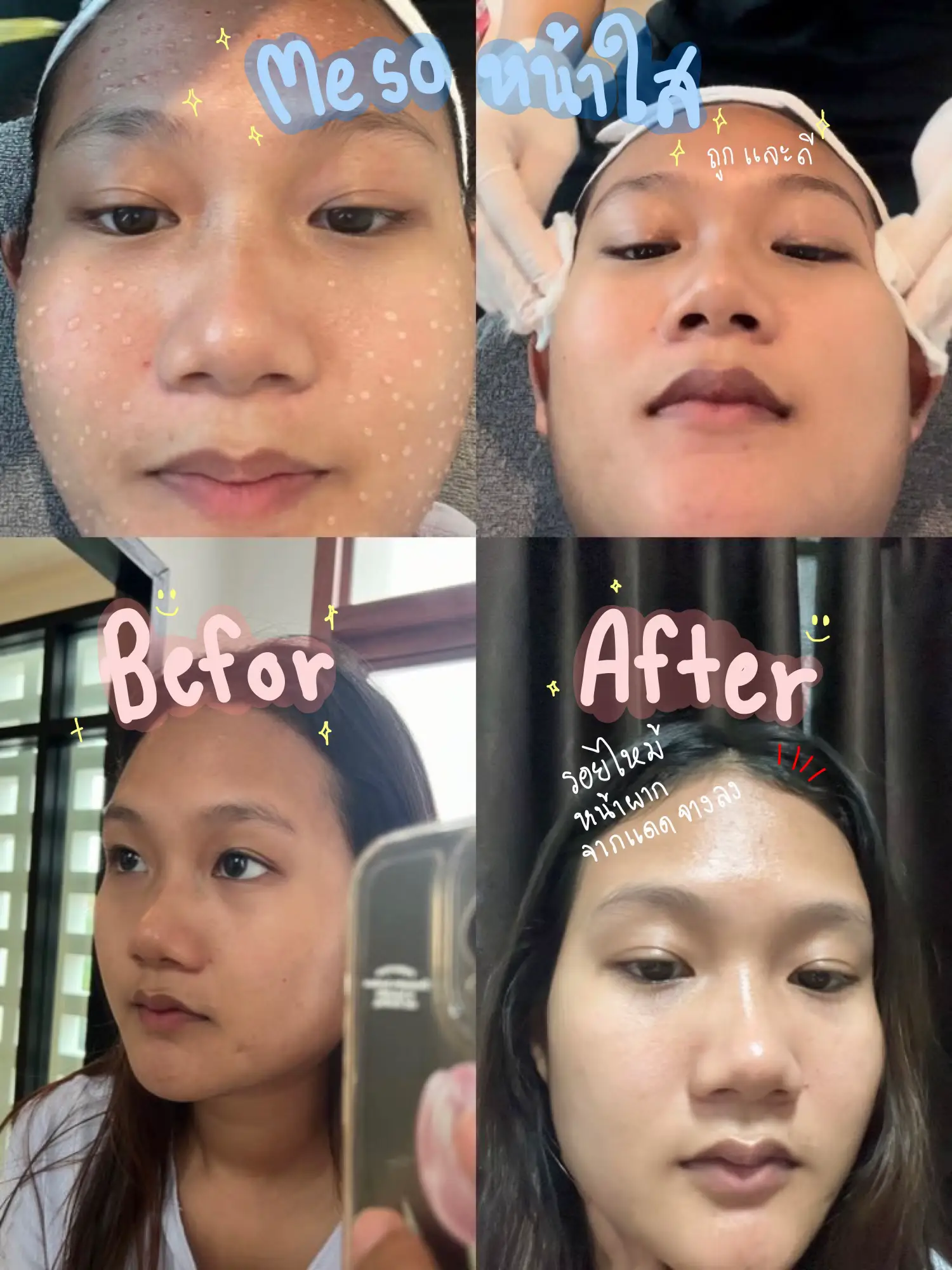 Meso หน้าใส ราคาจับต้องได้ ถูกใจนักศึกษา | แกลเลอรีที่โพสต์โดย Tam‘s life🐳 | Lemon8