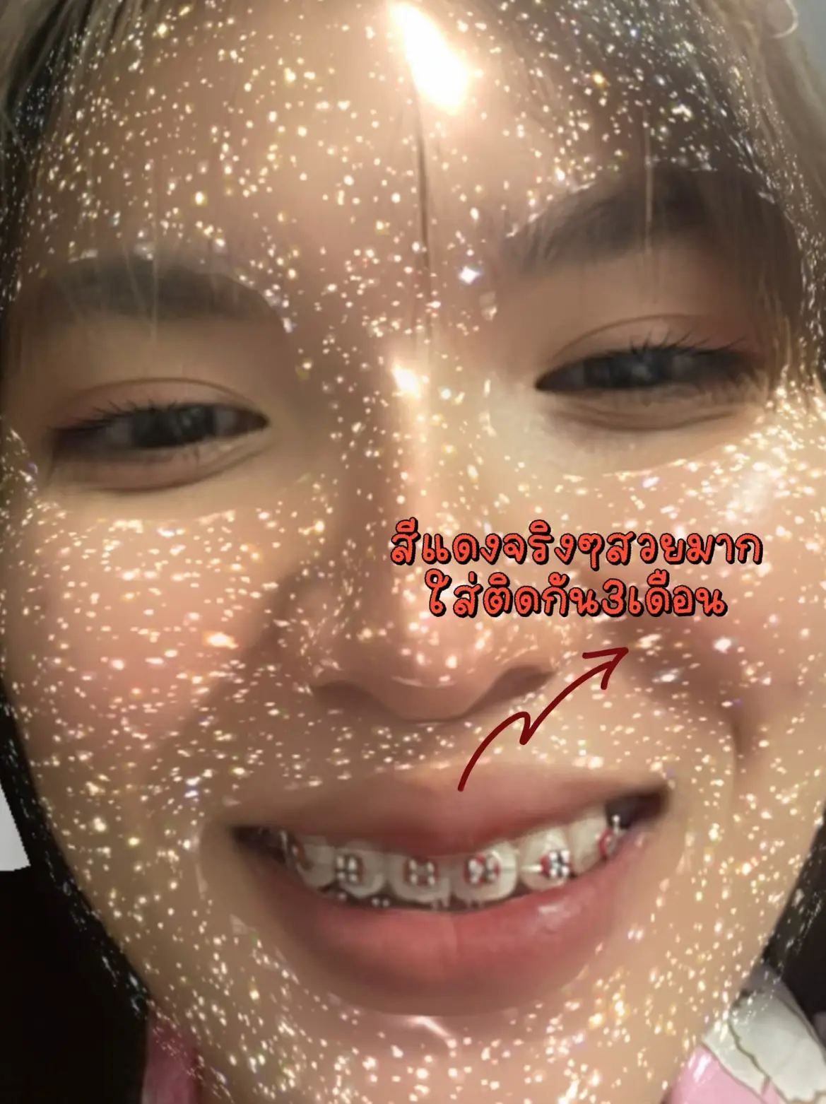 รีวิวสียางจัดฟันที่ชอบ😍 | แกลเลอรีที่โพสต์โดย Pk_cbn🐍 415🌈 | Lemon8