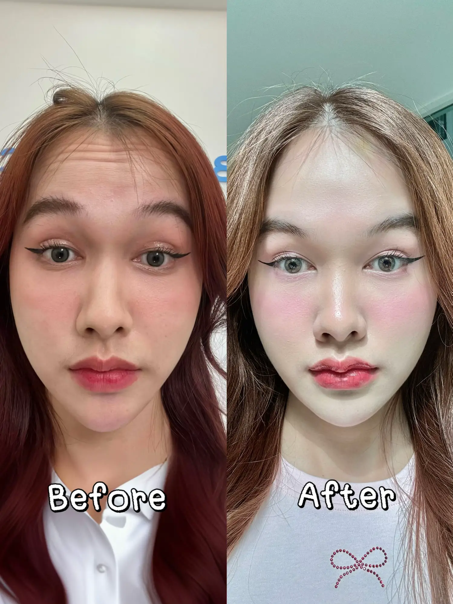 รีวิวโบริ้วรอยรอบที่ 2 ในวัย 23 ปี! | แกลเลอรีที่โพสต์โดย Yean | Lemon8