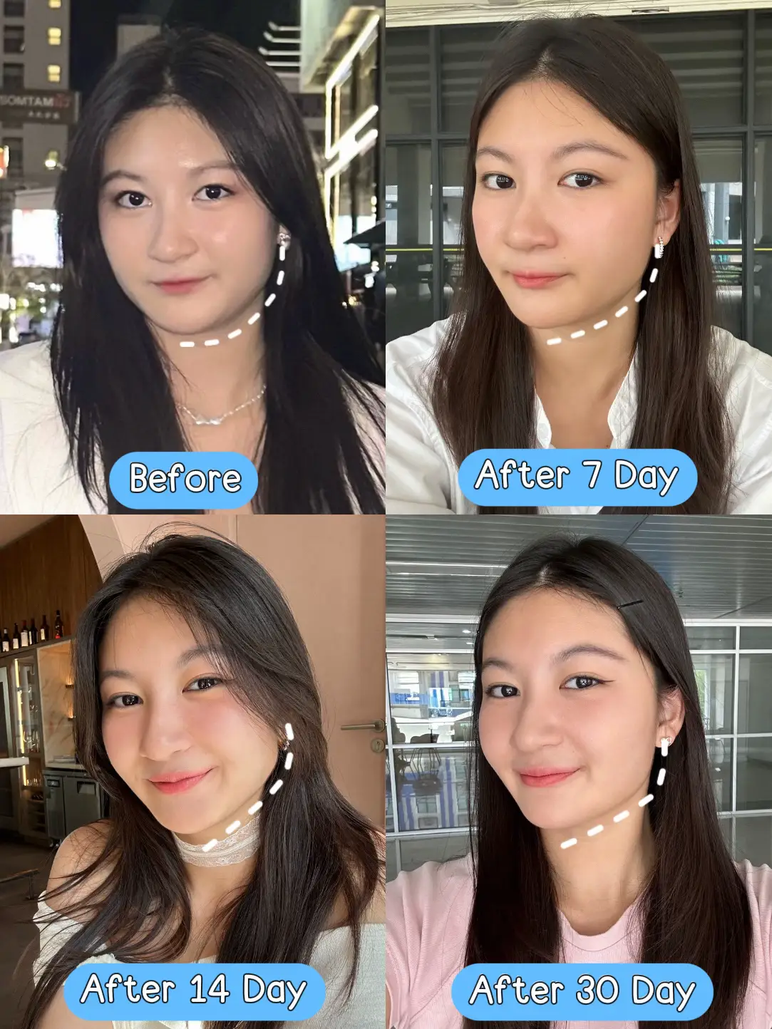 ฉีดหน้าครั้งแรกในชีวิต ปังแค่ไหน 🤩⁉️ | แกลเลอรีที่โพสต์โดย saavee | Lemon8