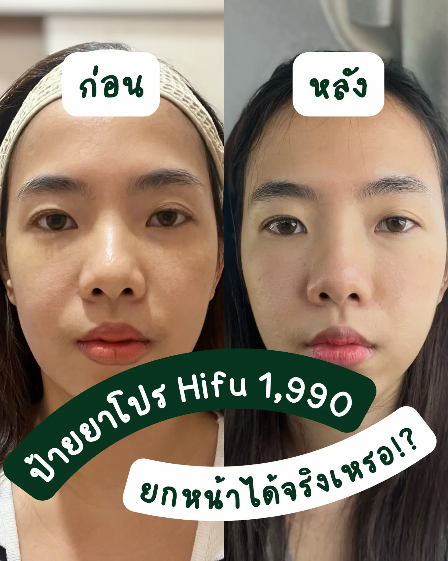 Premium Hifu สองแบ้งค์เทามีทอน เห็นผลจริง😱😱 | แกลเลอรีที่โพสต์โดย ตอเต่าป้ายยา💋👊🏻 | Lemon8