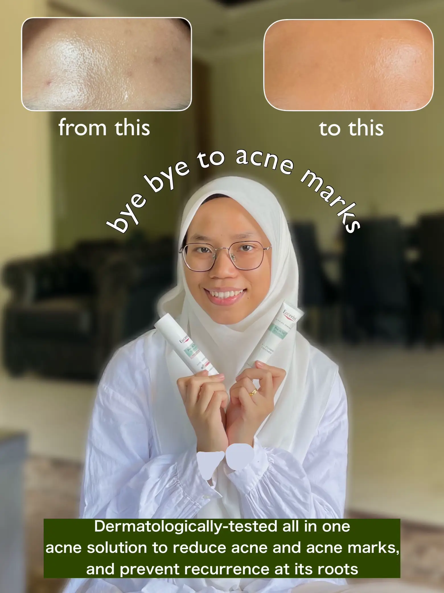 Acne Marks ?? Bye bye 😘 | แกลเลอรีที่โพสต์โดย anis | Lemon8